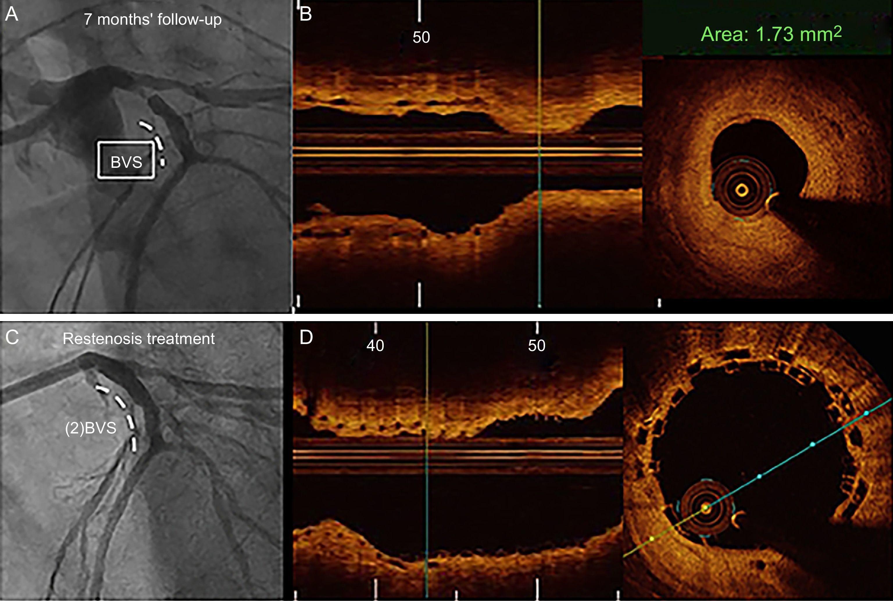 Restenosis After Everolimus-eluting Vascular Scaffolding. Angiographic ...
