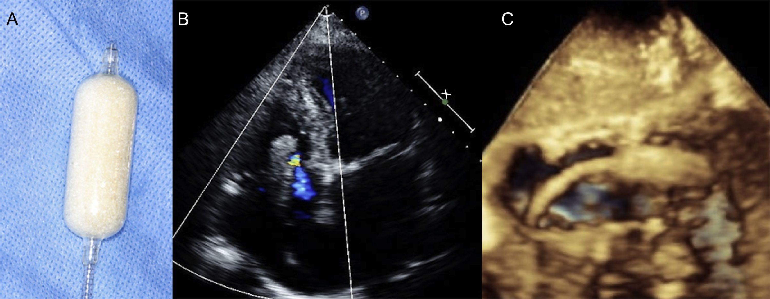 Percutaneous Treatment of the Tricuspid Valve Disease: New Hope for the ...
