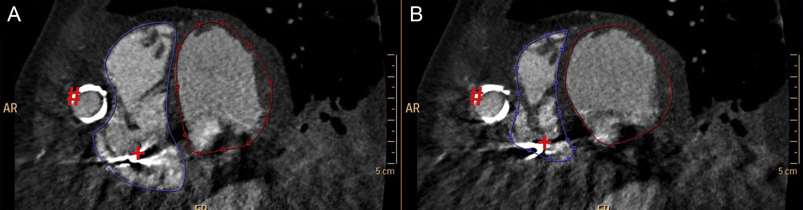 Comprehensive Assessment of the Heartware HVAD Left Ventricular Assist ...
