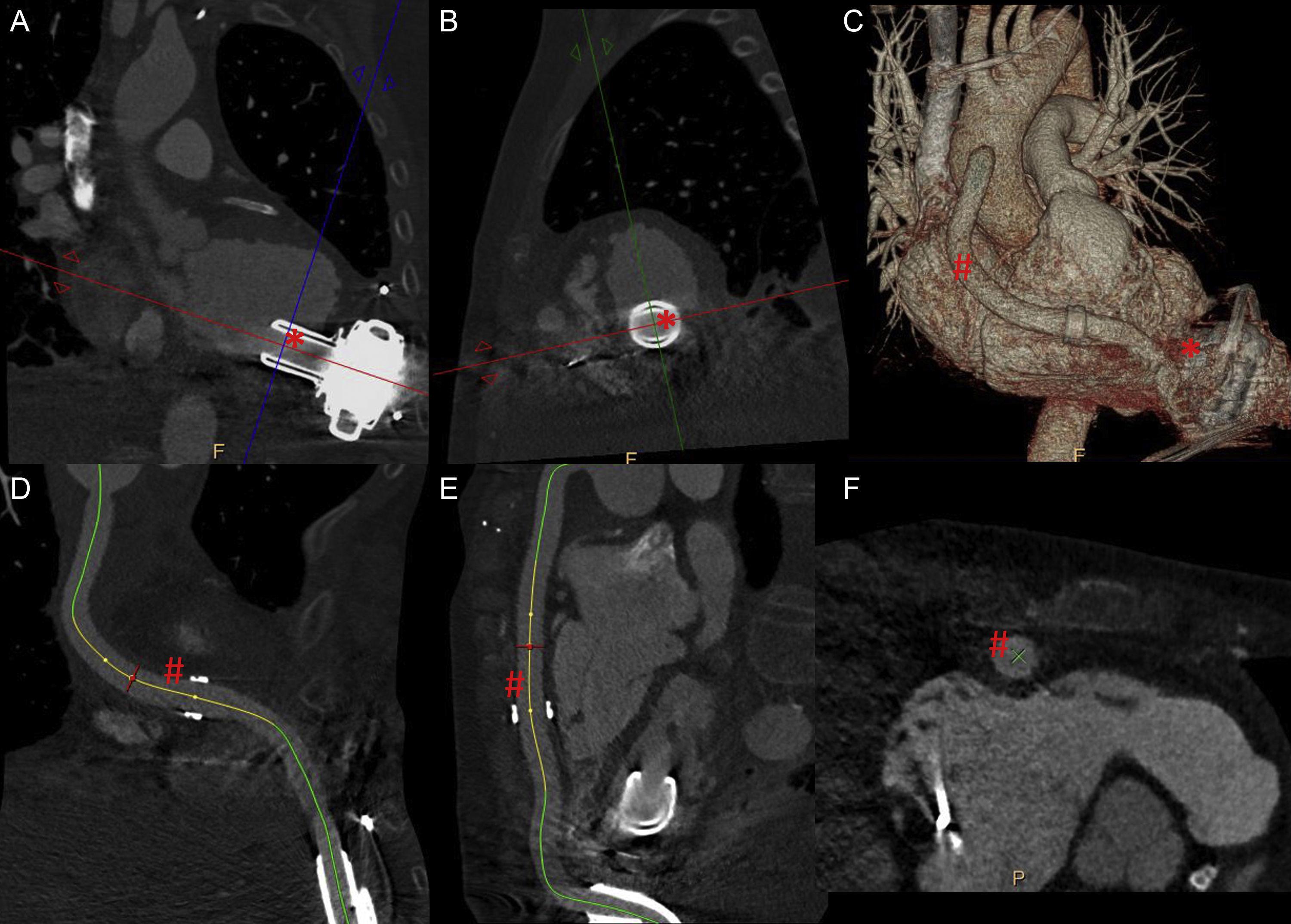 Comprehensive Assessment of the Heartware HVAD Left Ventricular Assist ...