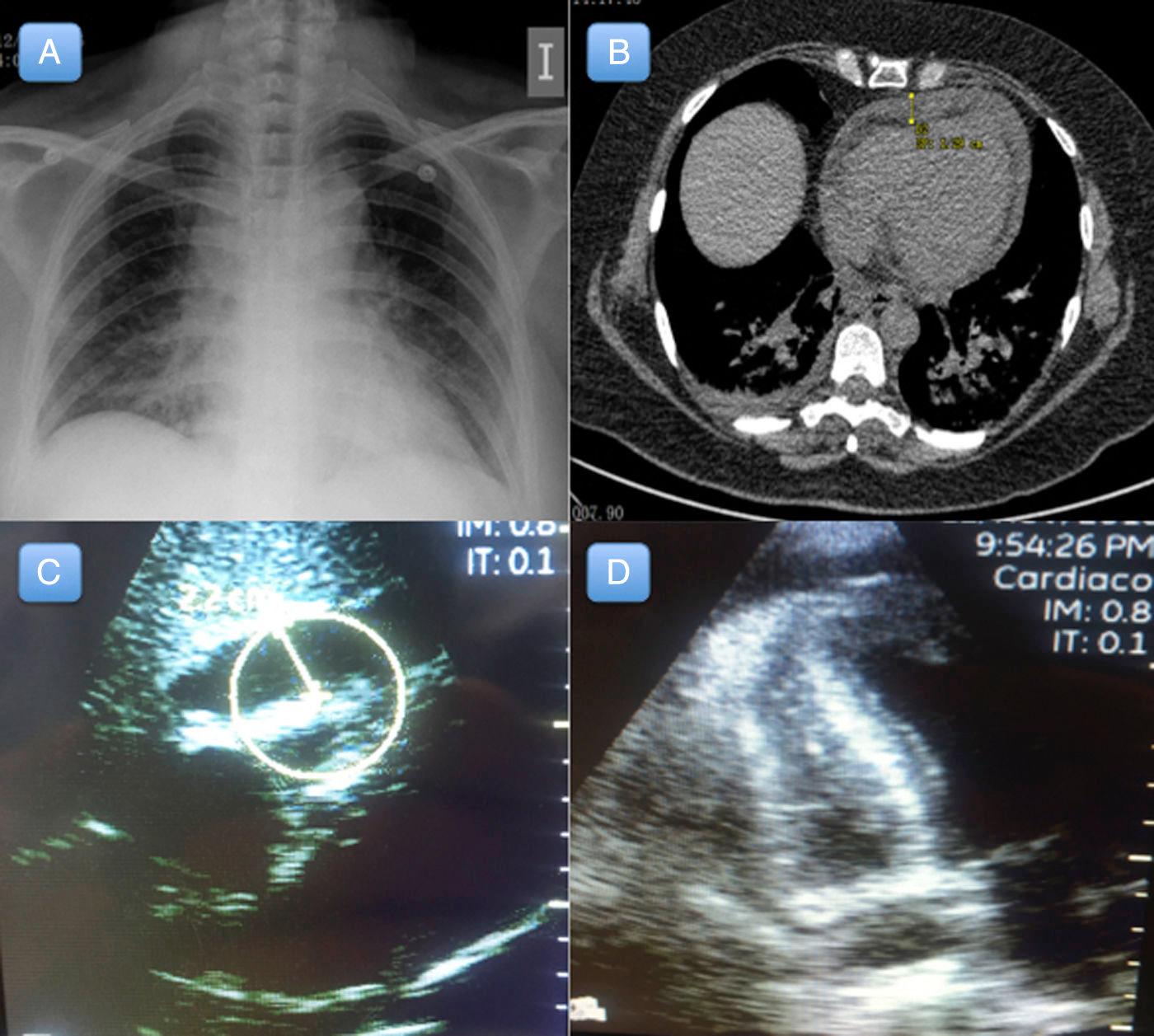 Cardiogenic Shock and Cardiac Tamponade in the Context of Influenza A ...