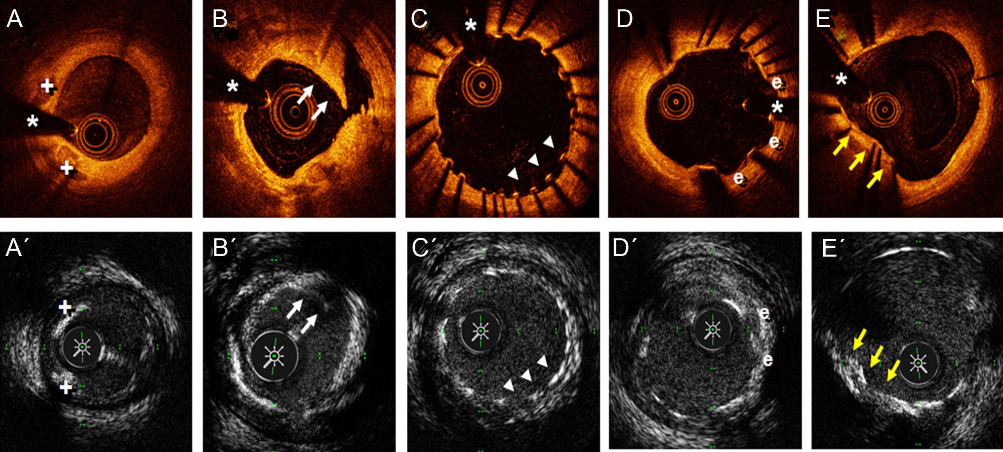 High-definition Intravascular Ultrasound Vs Optical Coherence ...