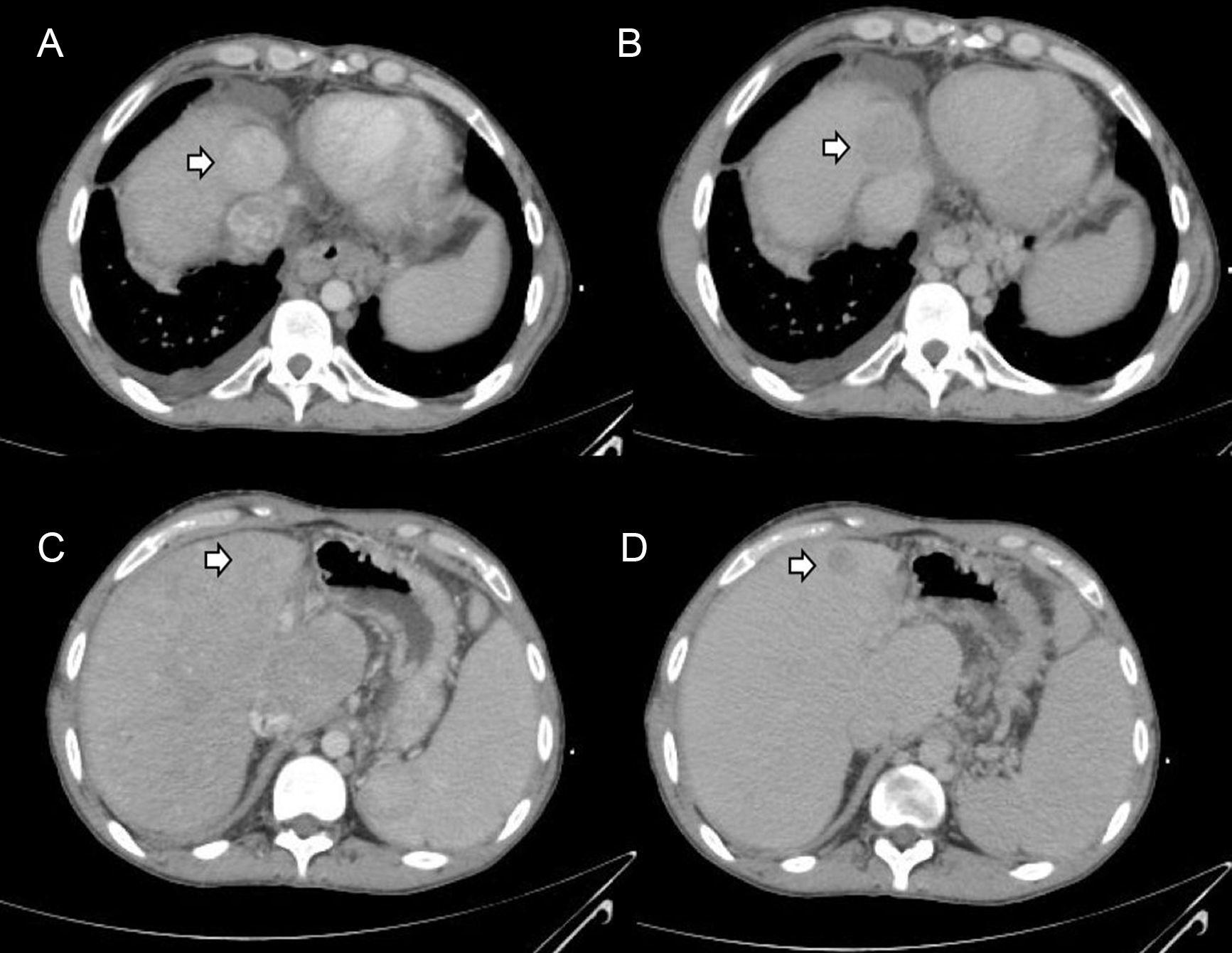 Fontan-associated Liver Disease | Revista Española de Cardiología
