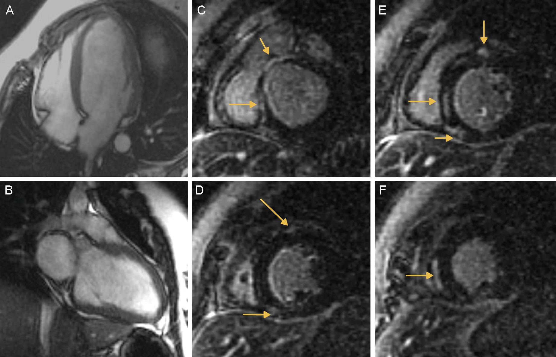 Alström Syndrome: A Rare Cause of Cardiomyopathy | Revista Española de ...