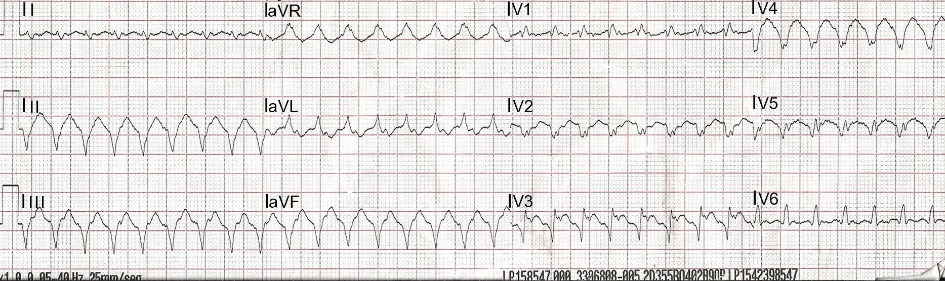 ECG, April 2018 | Revista Española de Cardiología