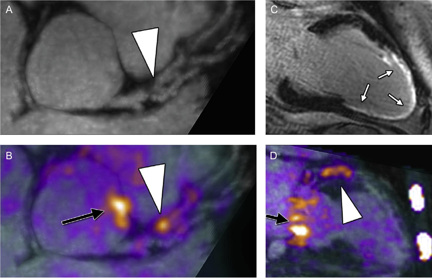 Hybrid Imaging in Ischemic Heart Disease | Revista Española de Cardiología