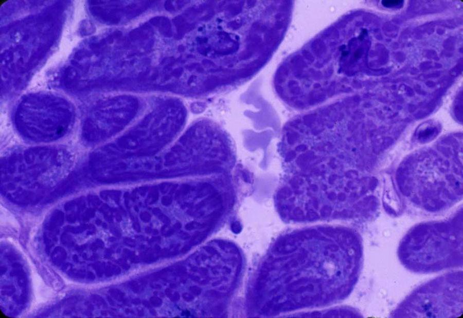 Reversibility of Alcohol Dilated Cardiomyopathy | Revista Española de ...