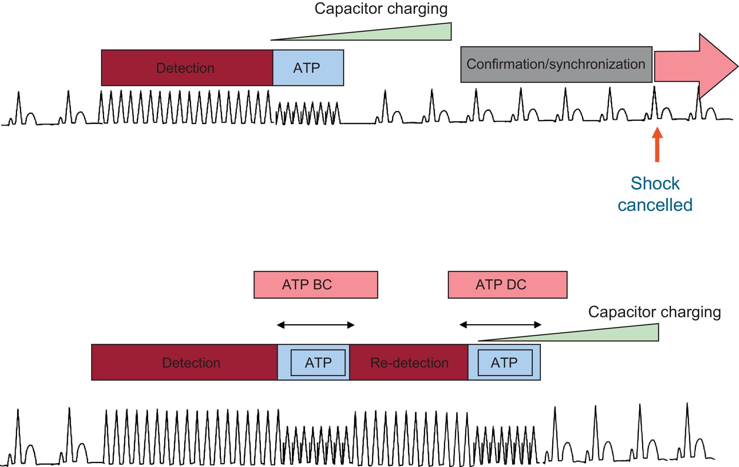 Shock Reduction With Antitachycardia Pacing Before and During Charging ...