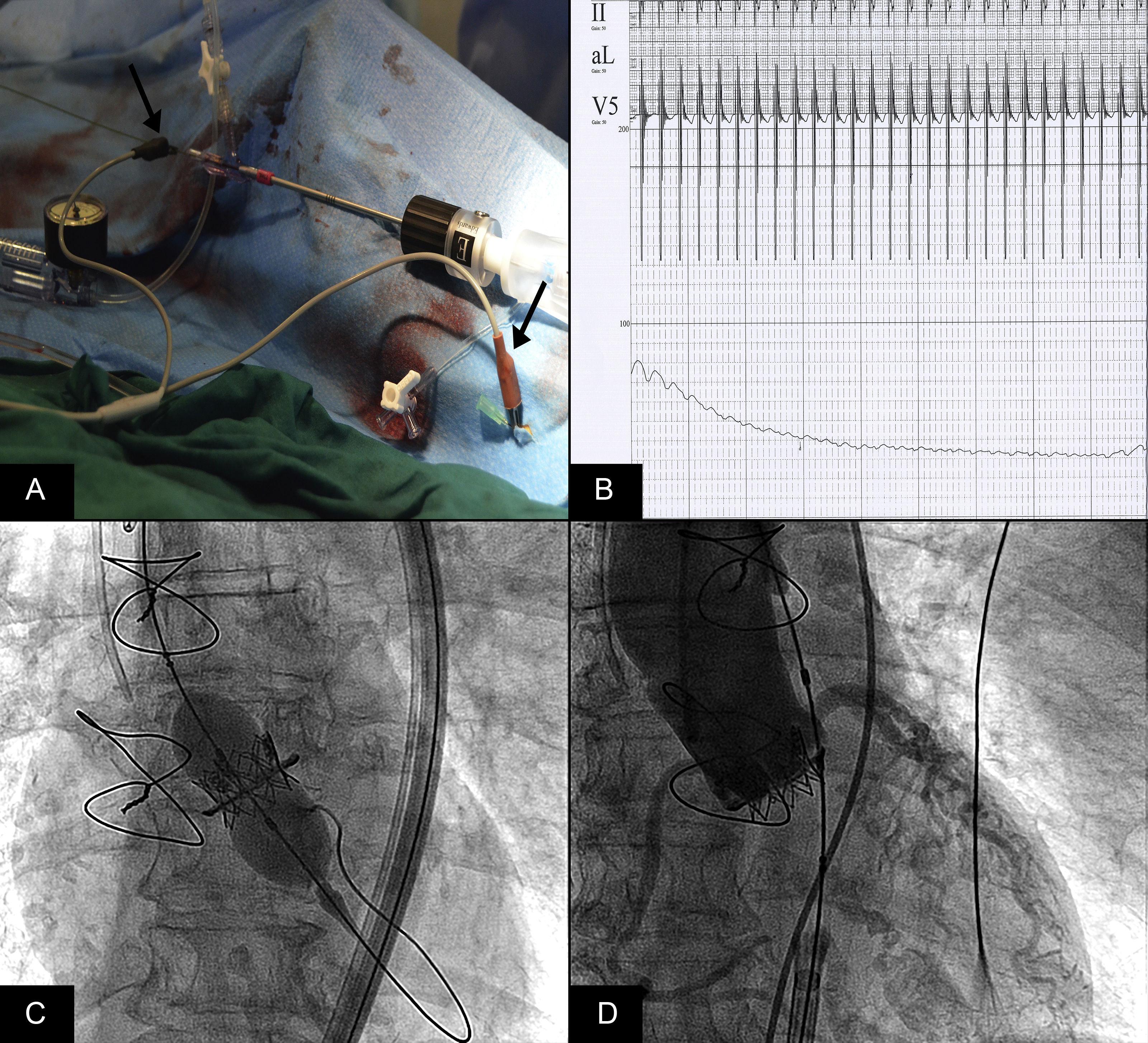 Guidewire-driven Left Ventricular Pacing During Transcatheter Aortic ...