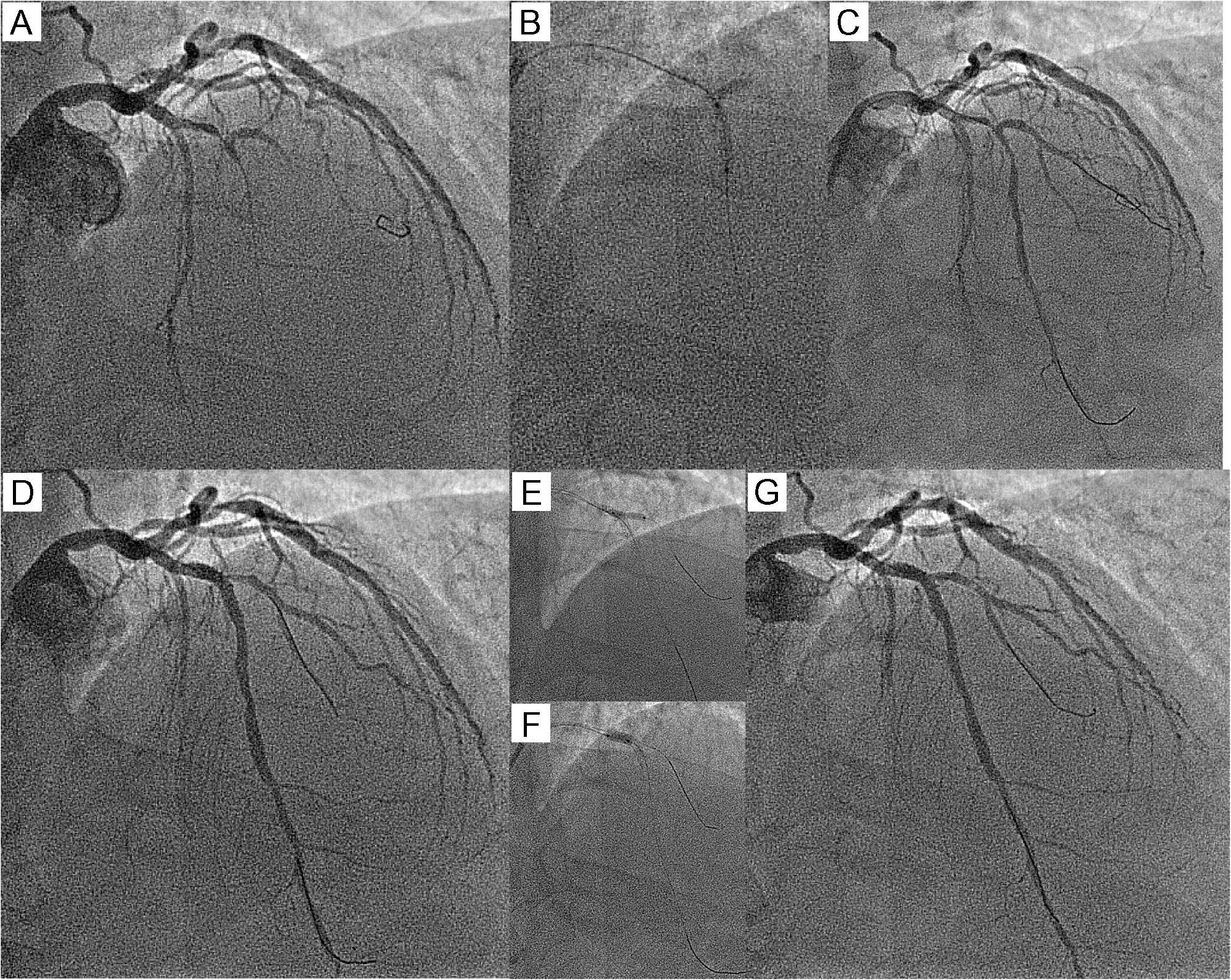 Bifurcation Lesions Causing an STEMI. Are They a Different Animal ...