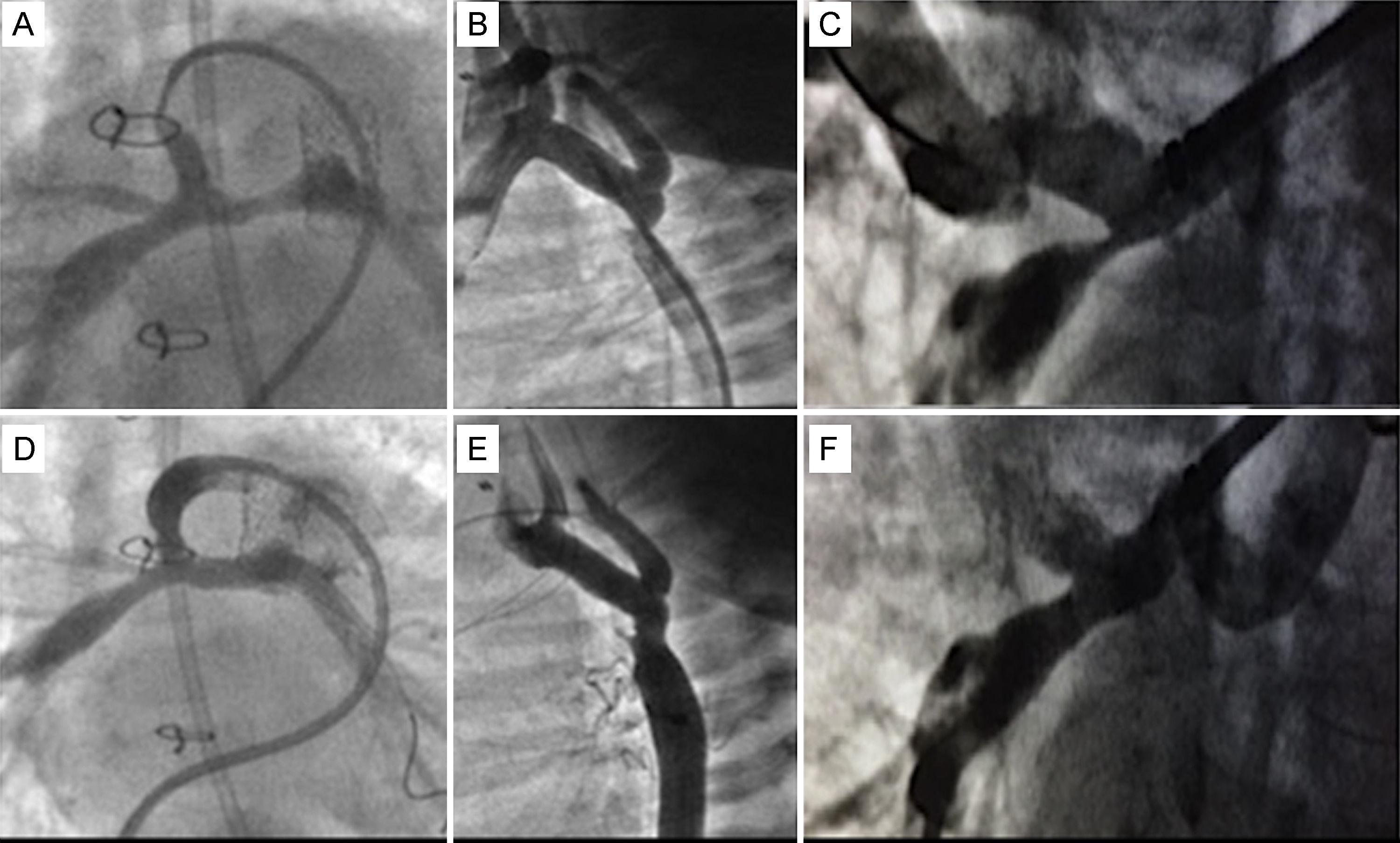Experience With the Absorb Bioresorbable Vascular Scaffold in Various ...