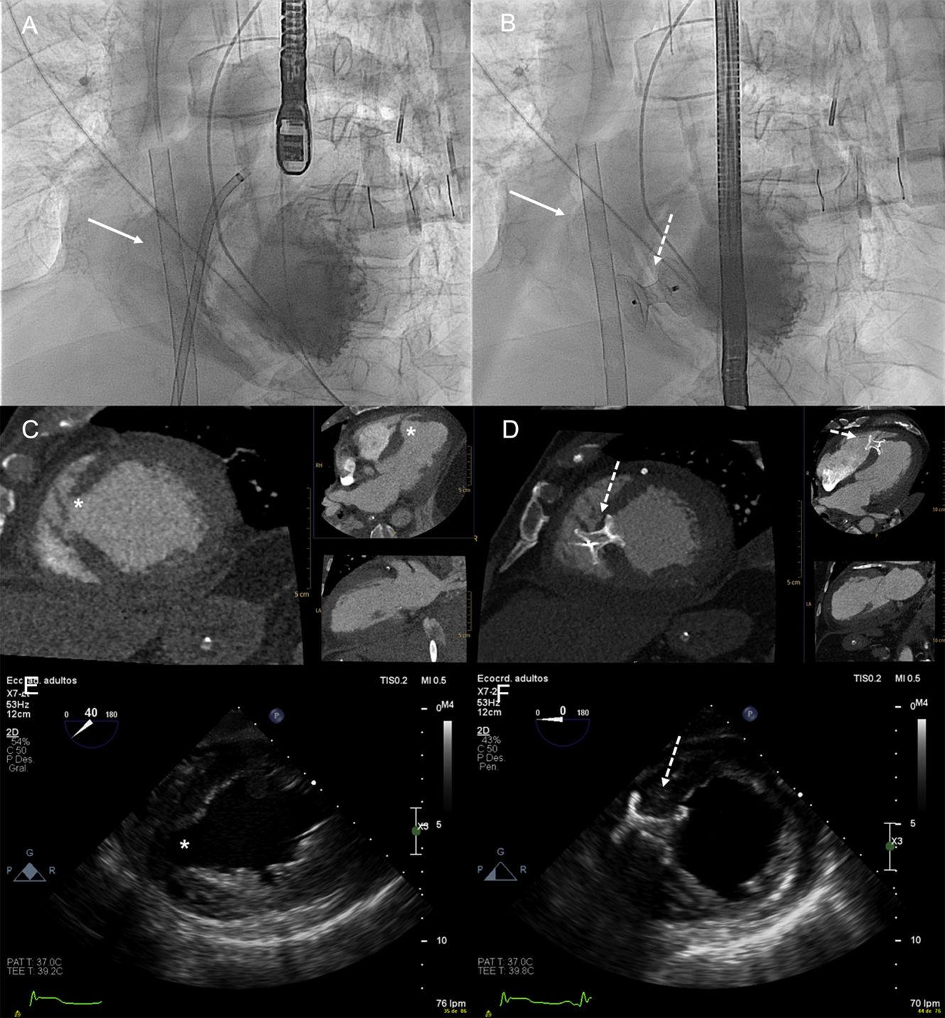 Device Closure of a Ventricular Septal Rupture in a Patient on ECMO ...