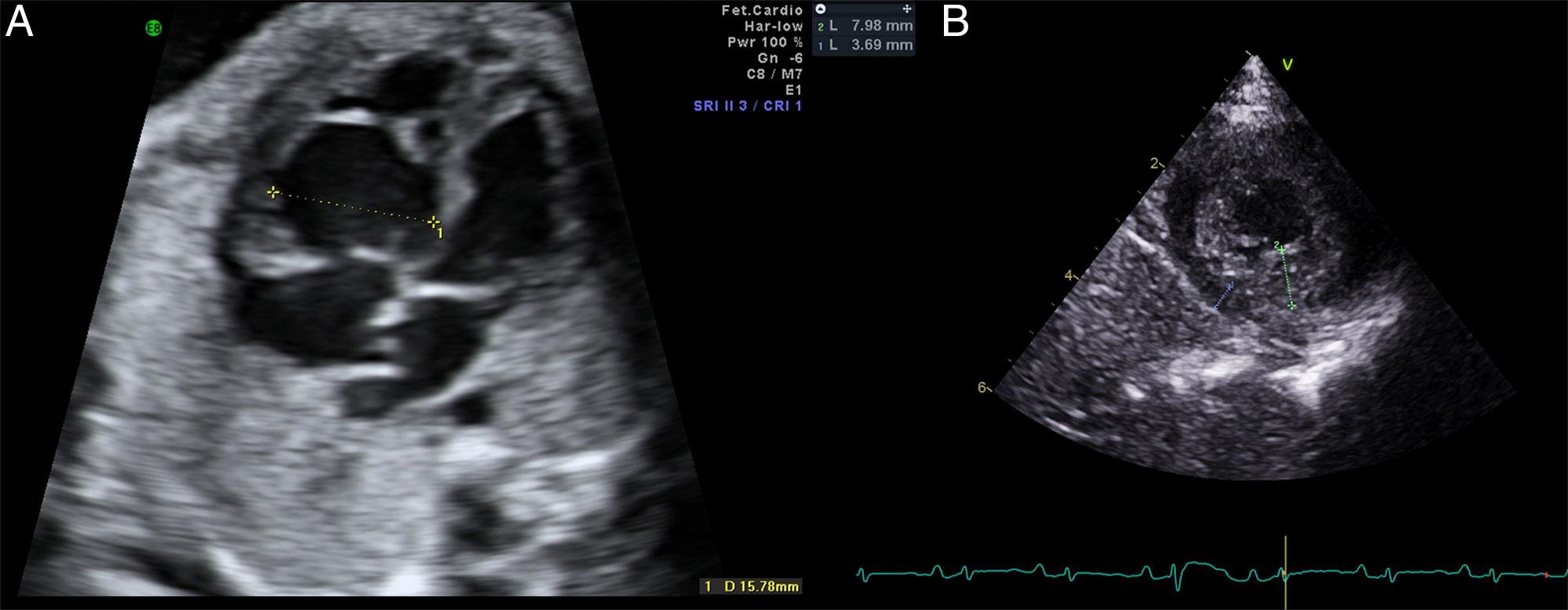 Undulating Clinical Course of Noncompaction Cardiomyopathy | Revista ...