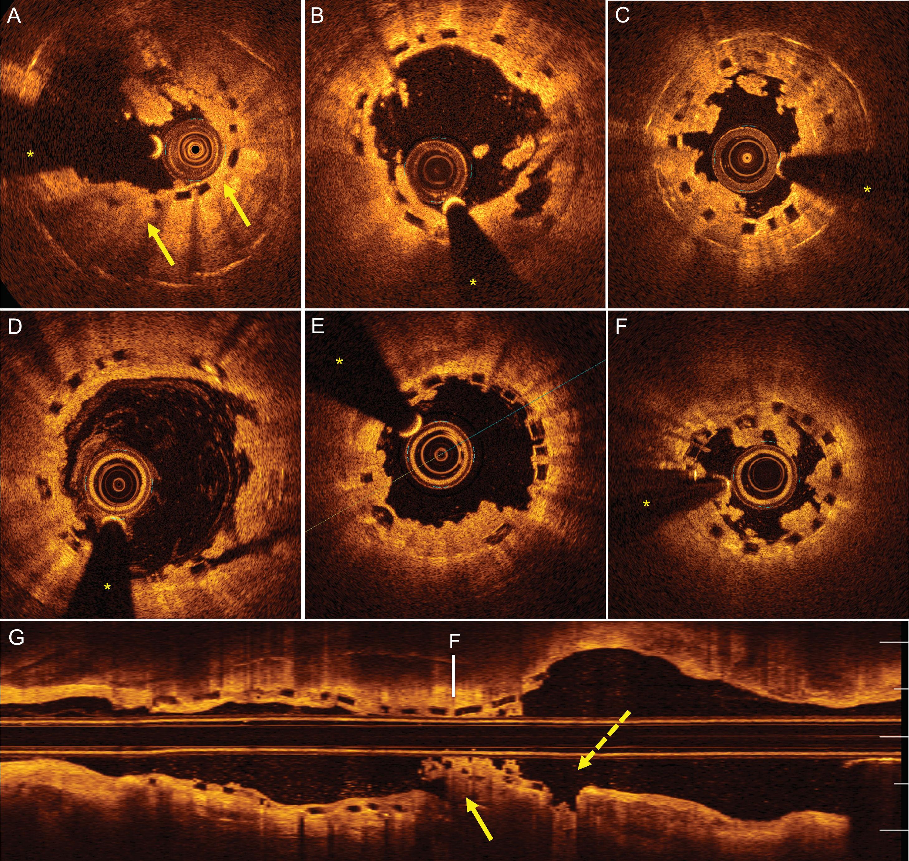 Bioresorbable Vascular Scaffold Thrombosis: Clinical and Optical ...