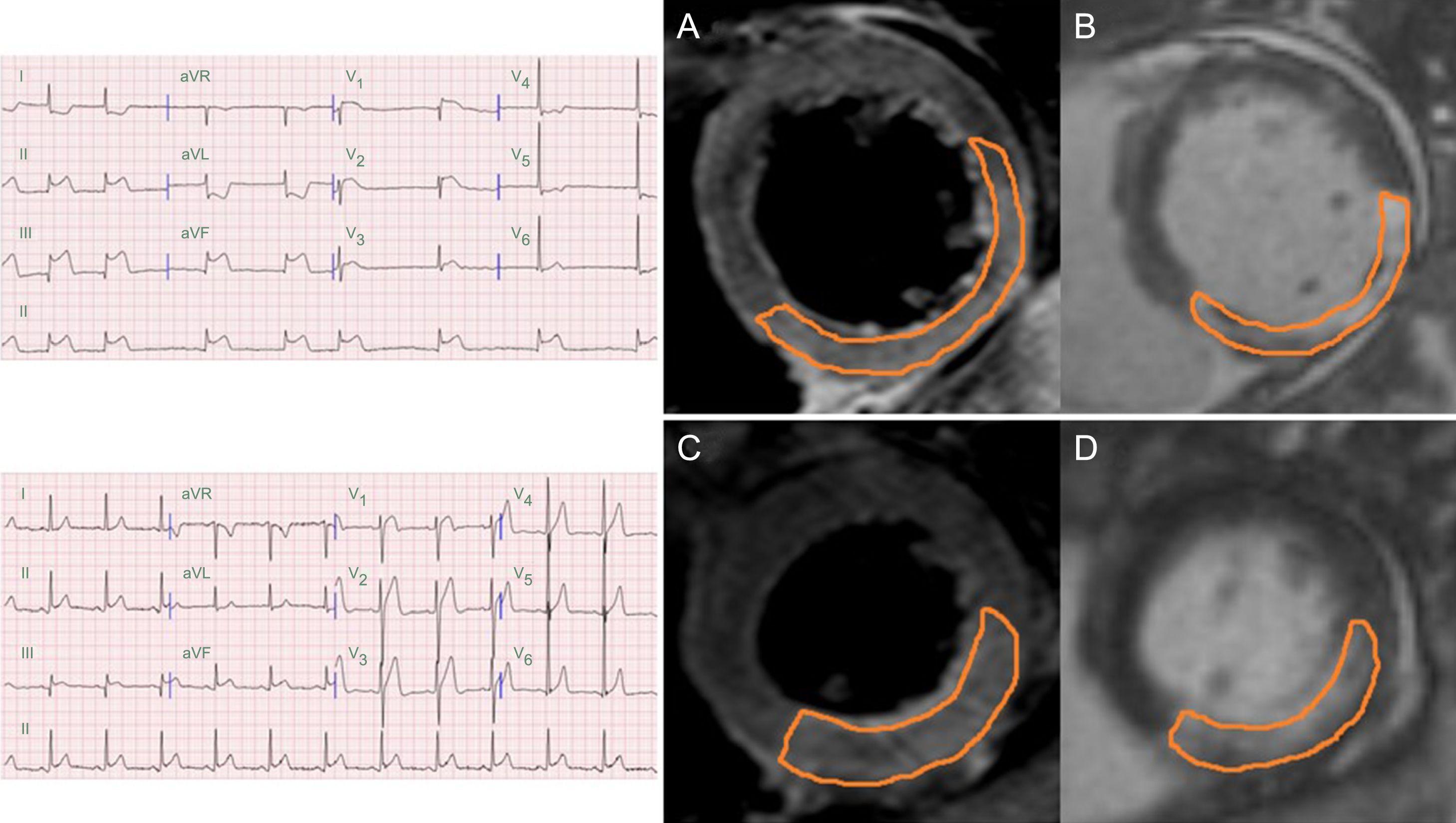 Clinical Significance of Reciprocal ST-segment Changes in Patients With ...