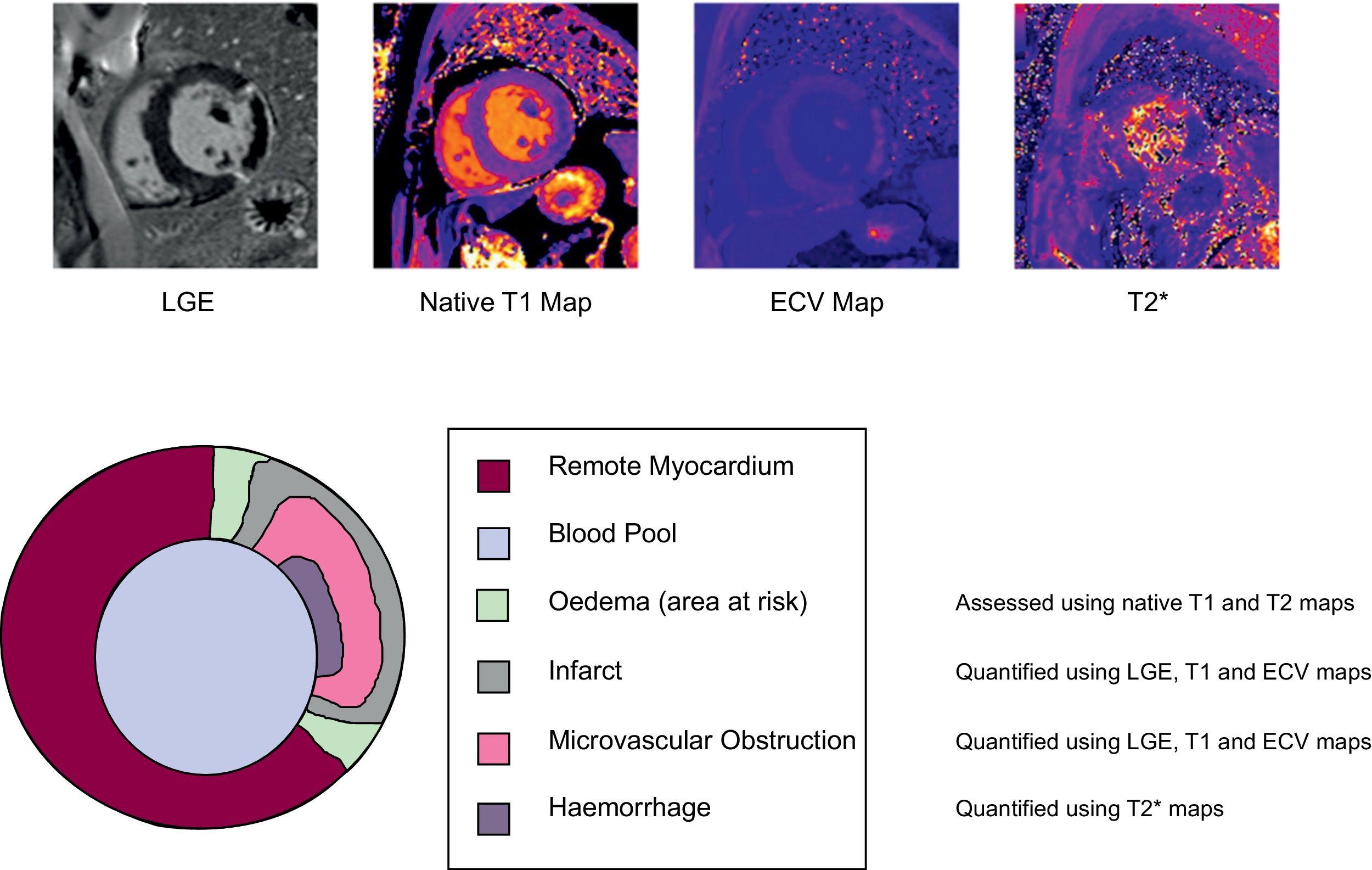 Role of CMR in Prognostic Stratification in Myocardial Infarction ...