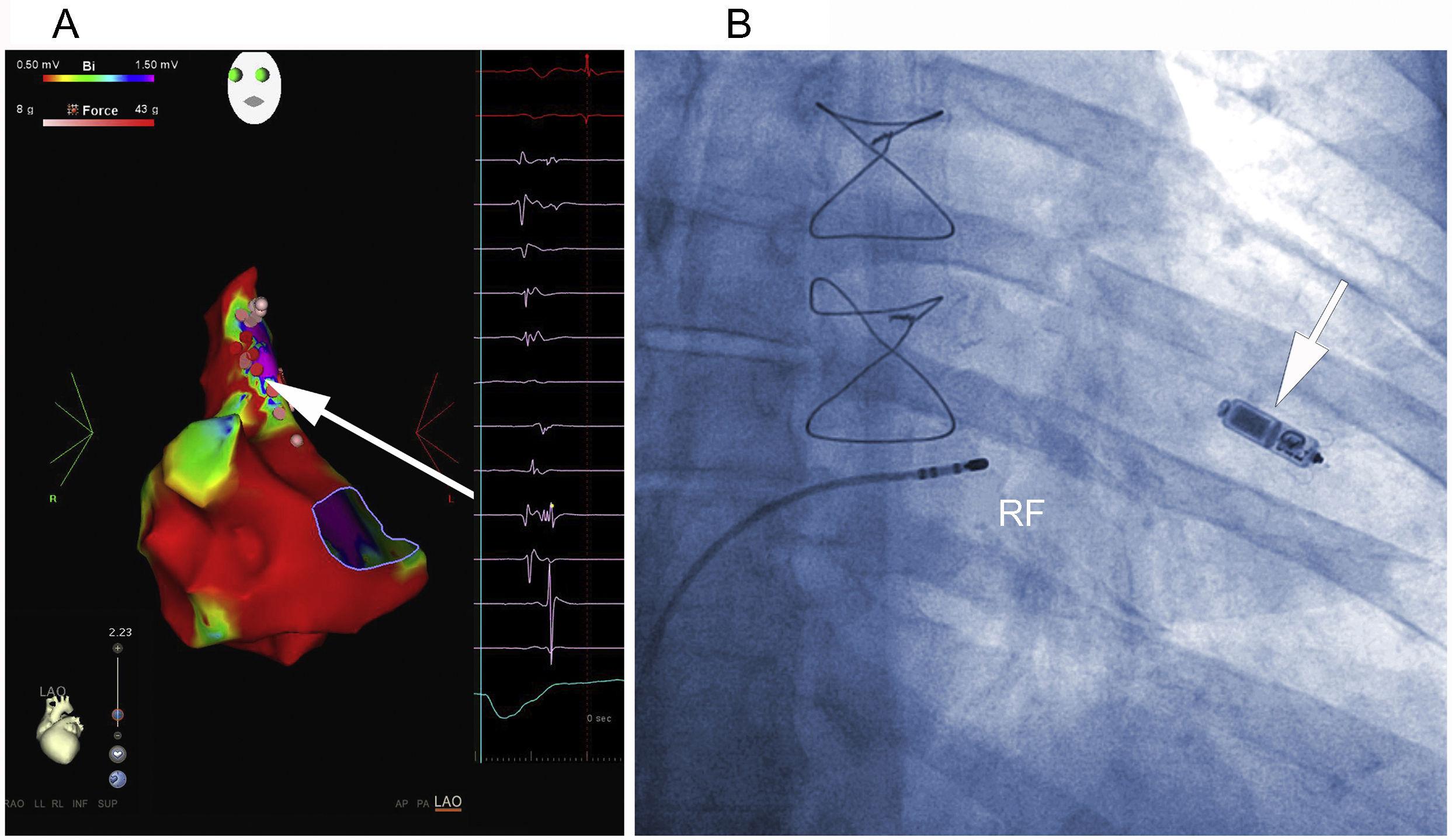 Leadless Pacemaker Implantation in a Transplanted Heart | Revista ...