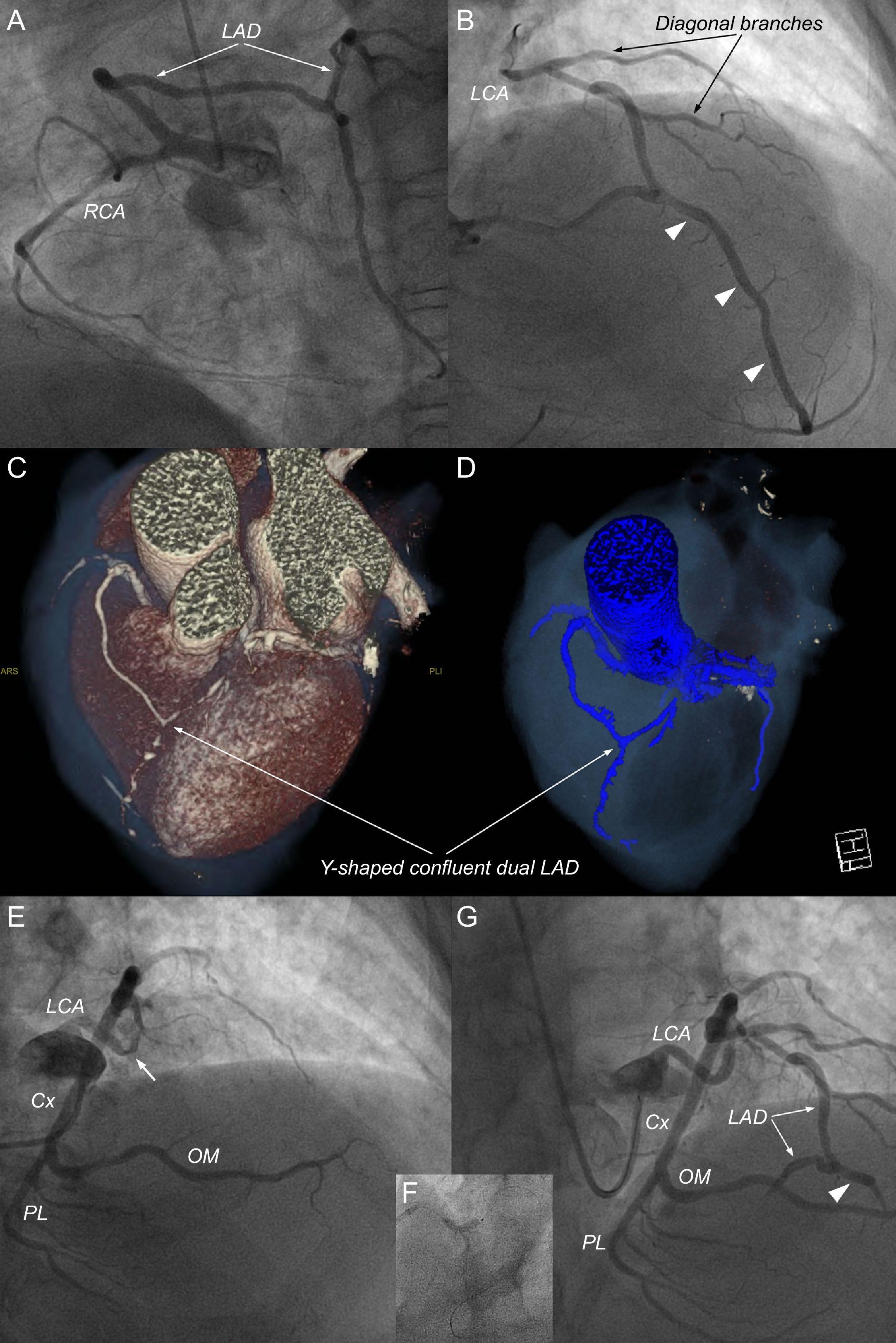 Y-shaped Dual Left Anterior Descending Artery or Coronary Collateral ...
