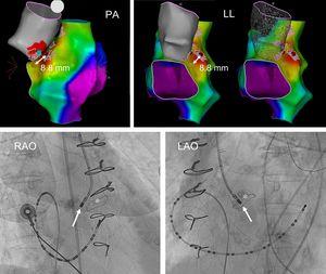 Catheter Ablation of Peri-Hisian Atrial Tachycardia From the ...