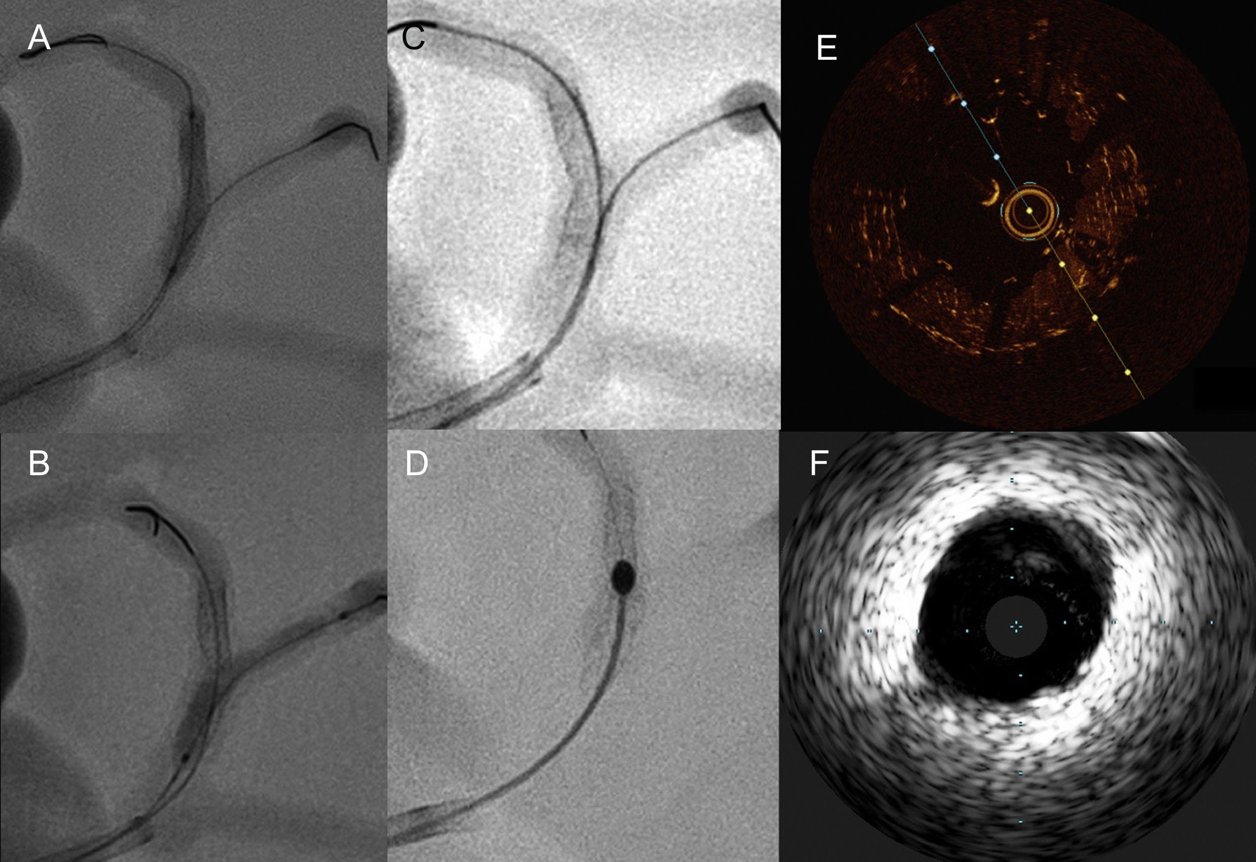 A 3D Printed Patient-specific Simulator for Percutaneous Coronary ...