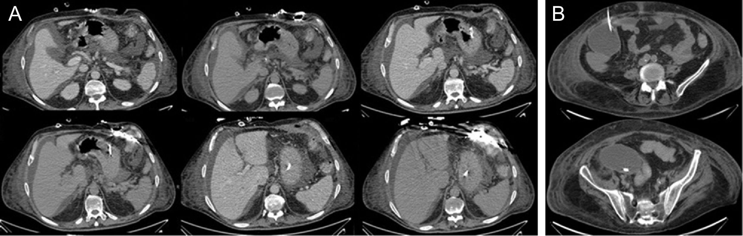 Enterocutaneous Fistula After Heart Transplant: A Consequence of a Left ...
