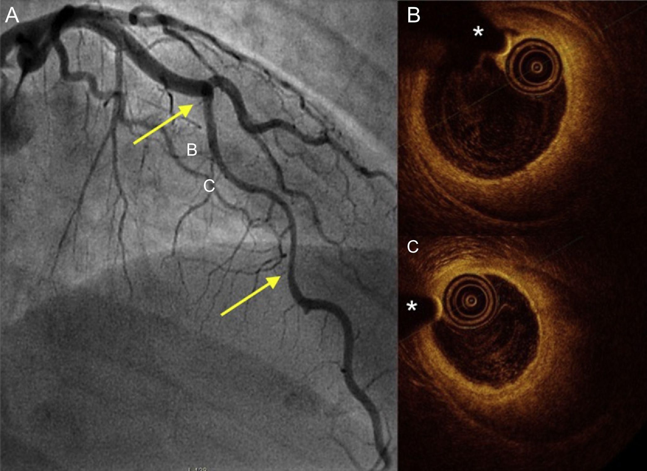 Spontaneous Coronary Artery Dissection and Hypothyroidism | Revista ...