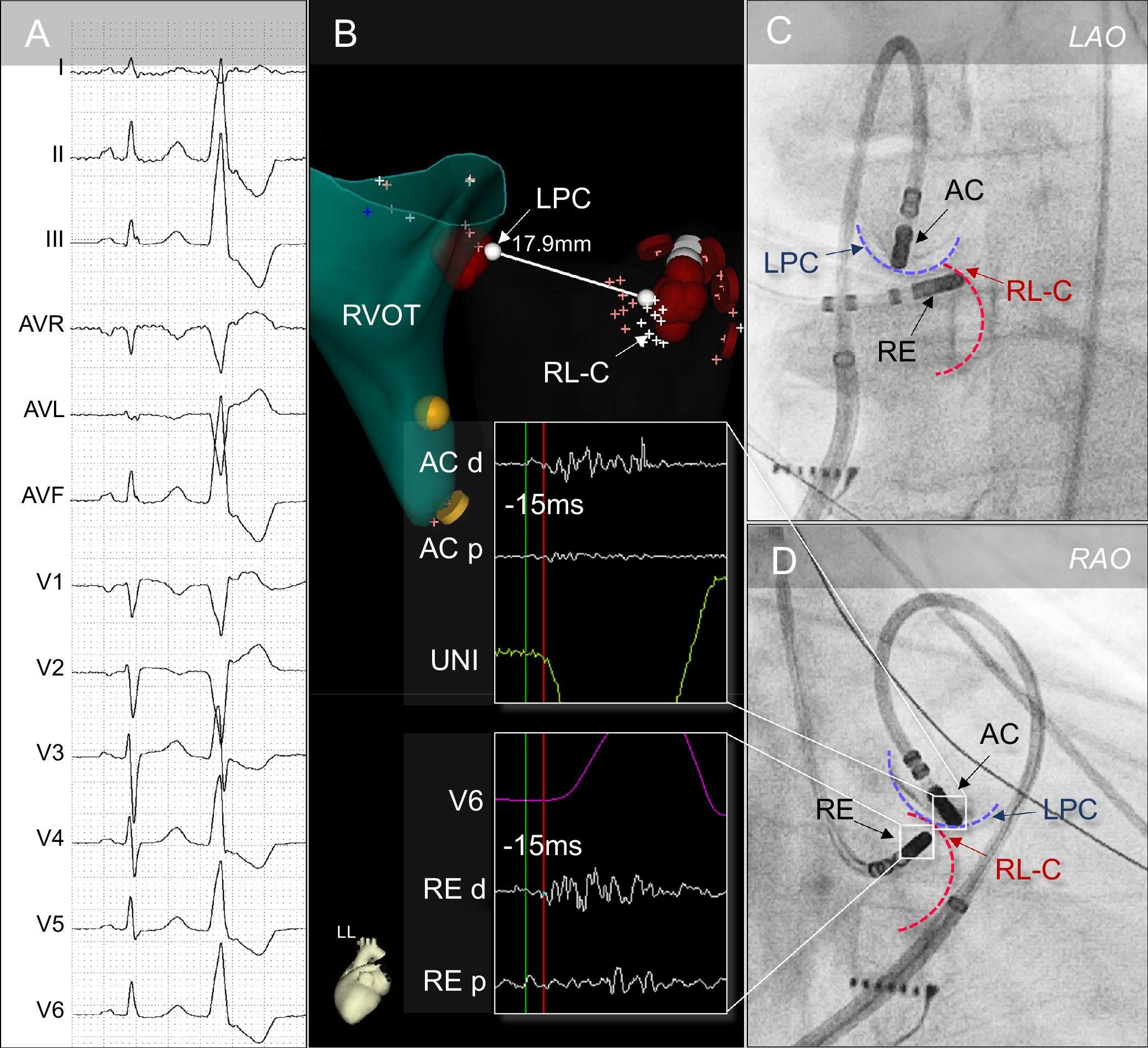 Bipolar Ablation Delivered Between the Pulmonary and Aortic Valve Cusps ...