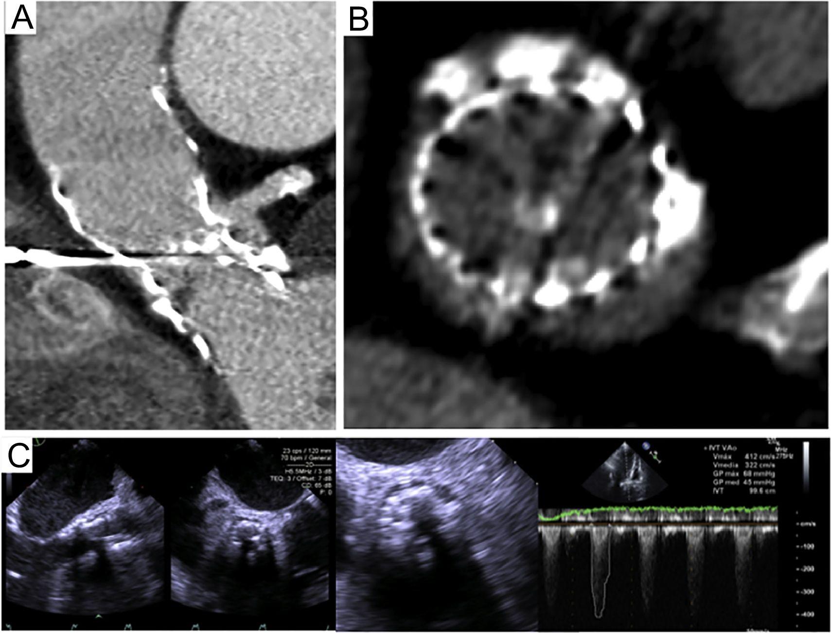 Degenerated aortic self-expanding prosthesis: percutaneous valve-in ...