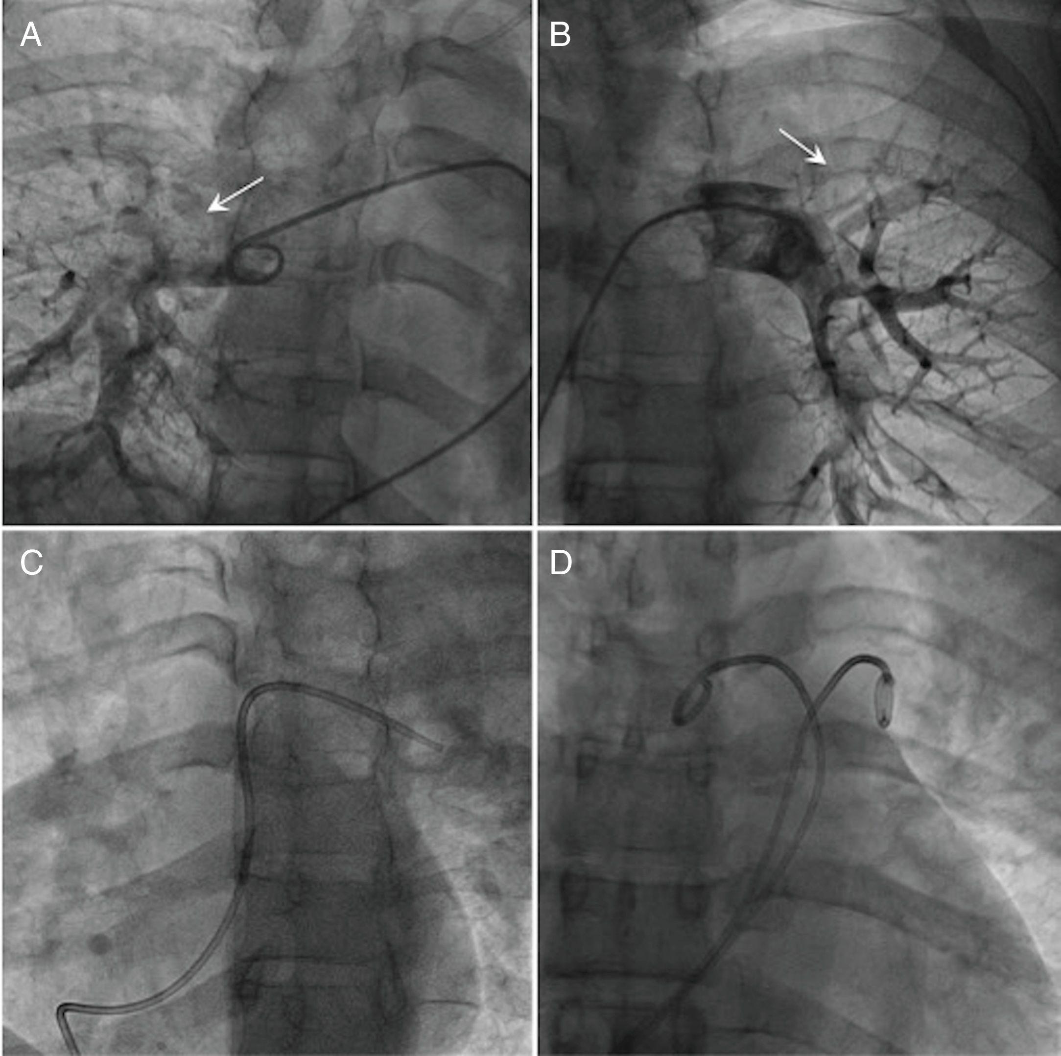 Percutaneous treatment of pulmonary embolism during pregnancy | Revista ...