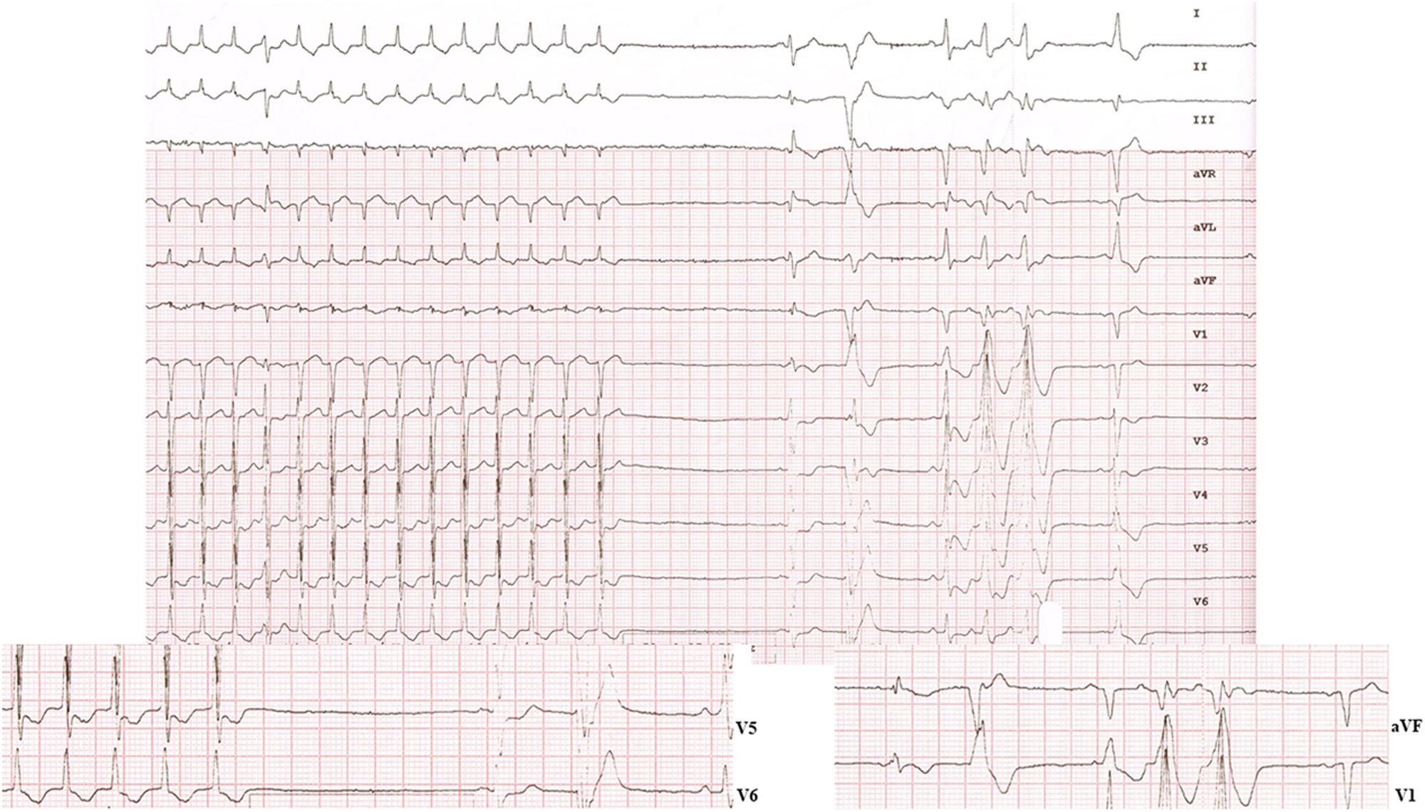 ECG, May 2020 | Revista Española de Cardiología