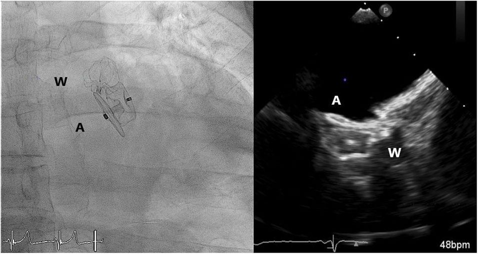 Left atrial appendage closure with 2 different devices | Revista ...