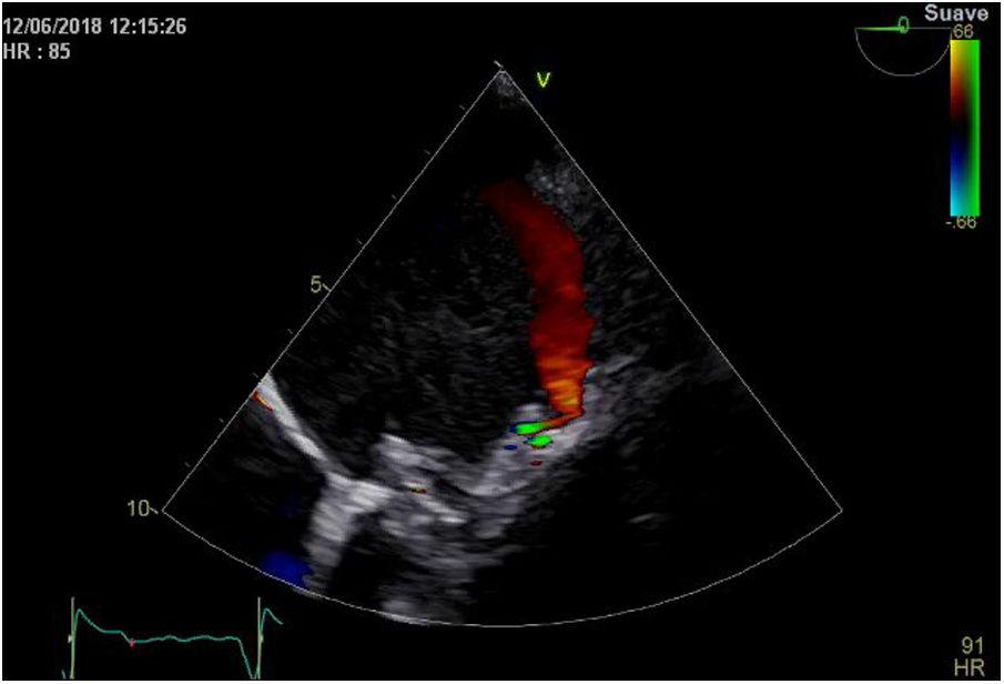Modified LAMPOON technique | Revista Española de Cardiología
