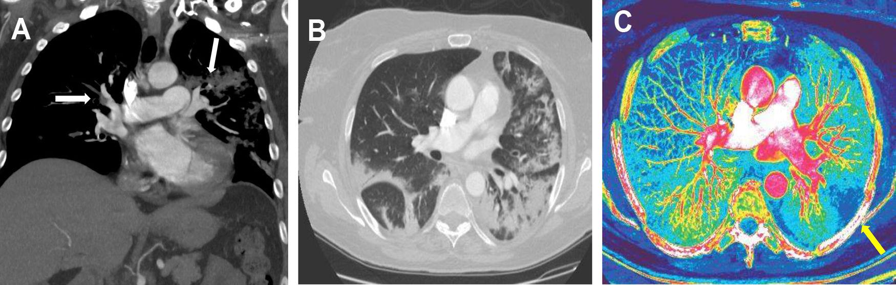 Pulmonary infarction secondary to pulmonary thromboembolism in COVID-19 ...