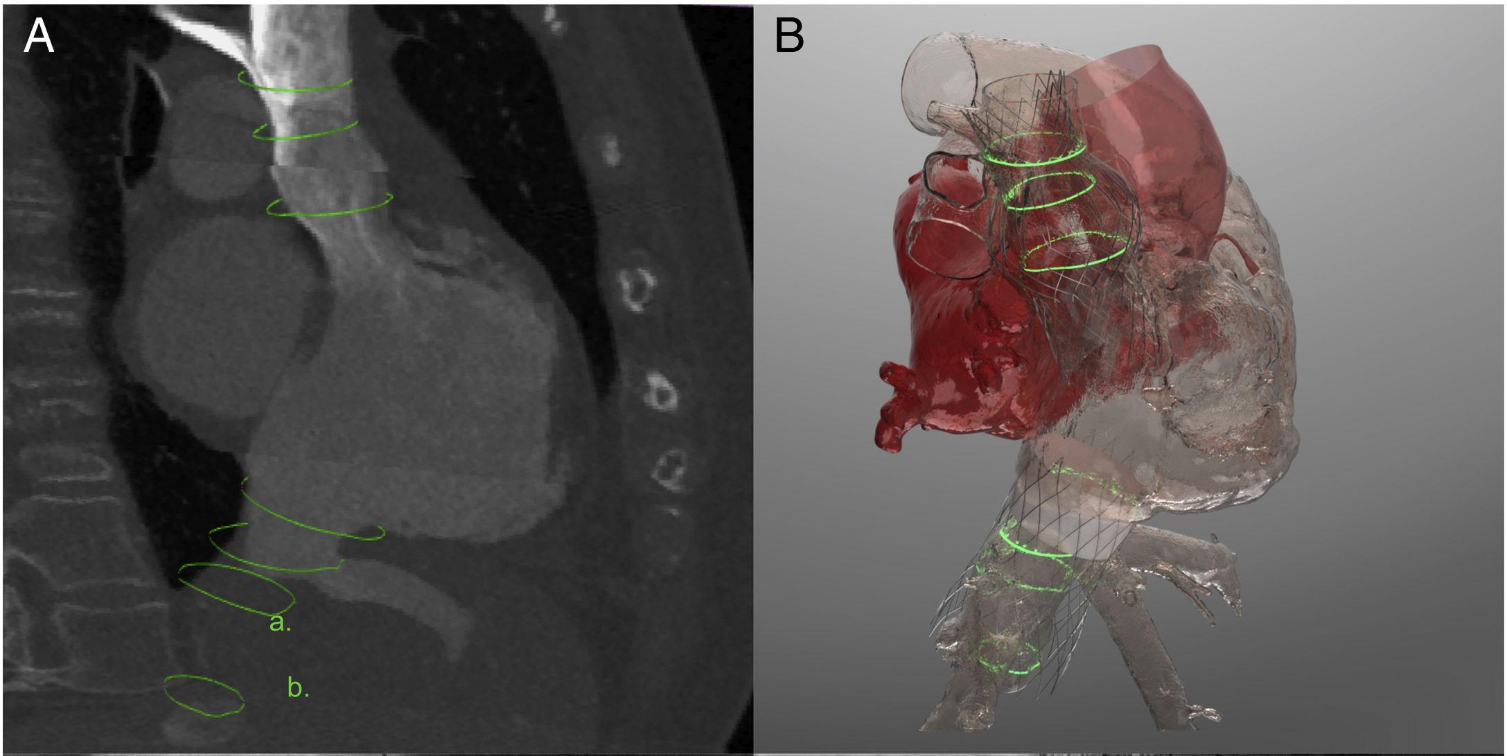 Current clinical outcomes of tricuspid regurgitation and initial ...