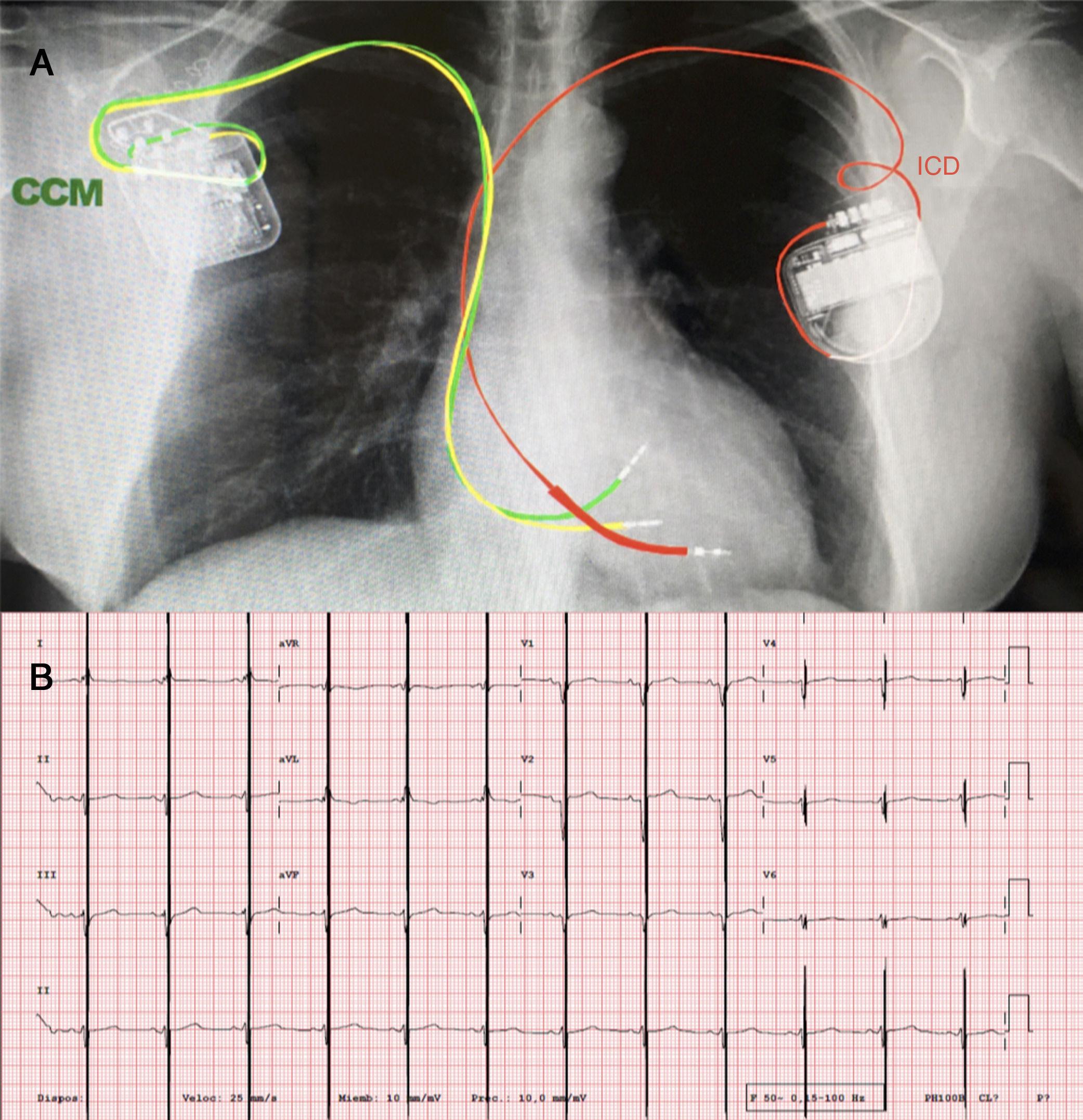 First experience in Spain of cardiac contractility modulation. A new ...