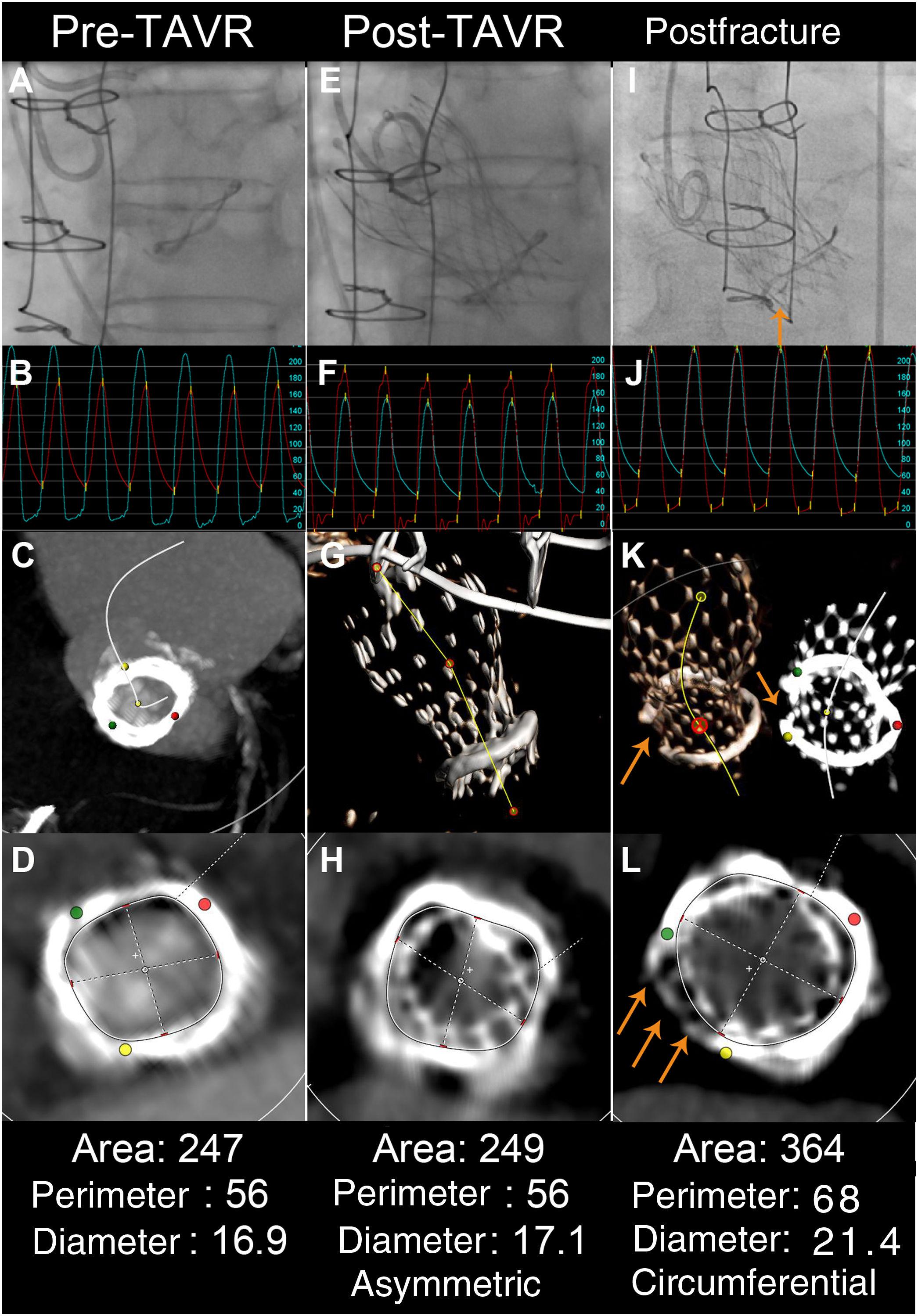 Bioprosthetic aortic valve fracture: evaluation by serial cardiac CT ...