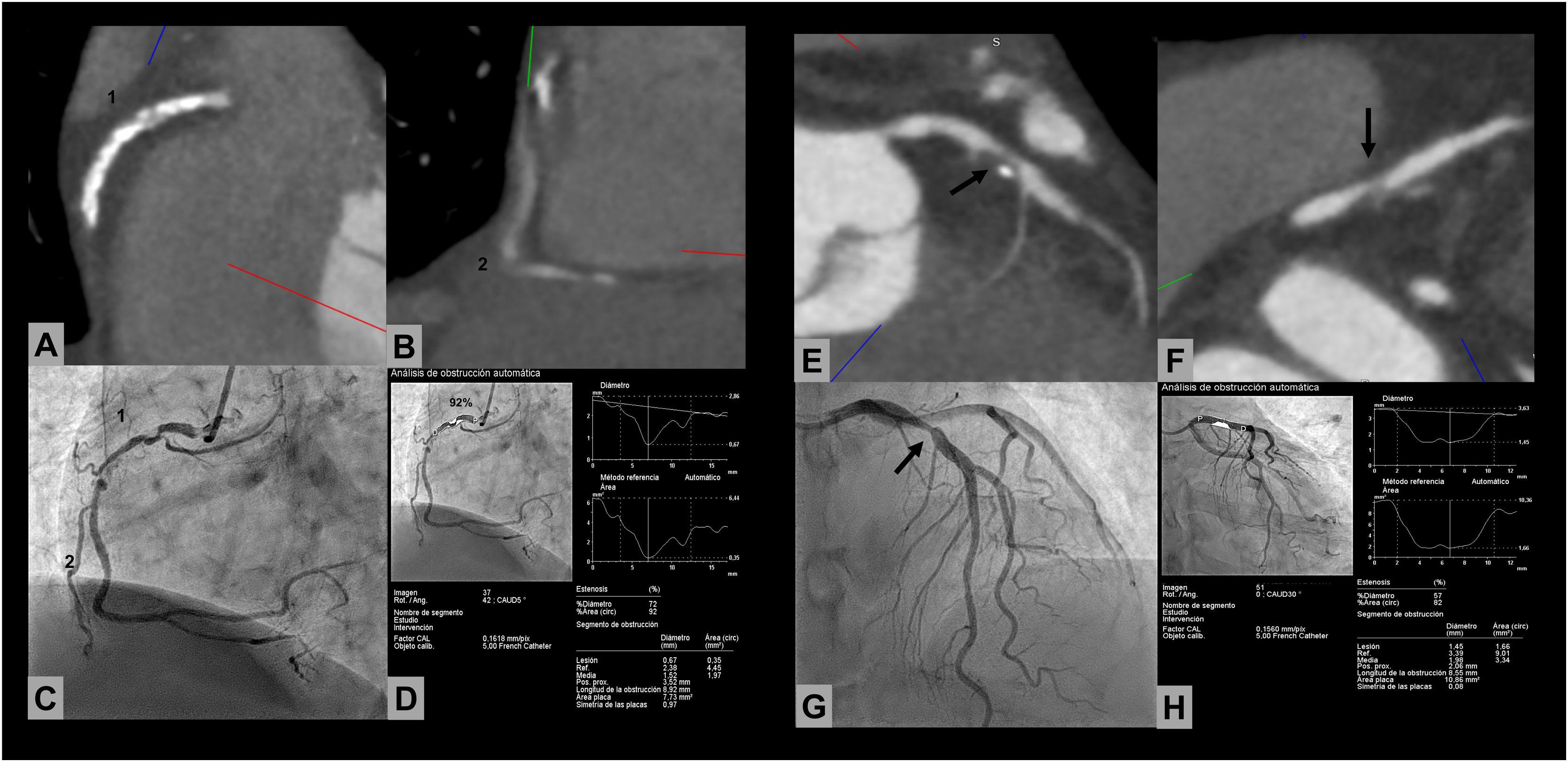 Coronary arterial segmental stenosis quantified by MDCT: correlation ...