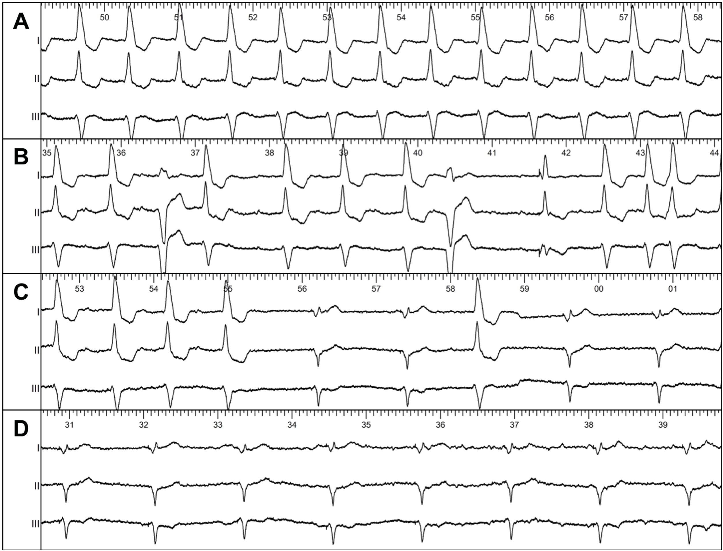 Alcohol ablation of atrioventricular conduction for rate control in ...
