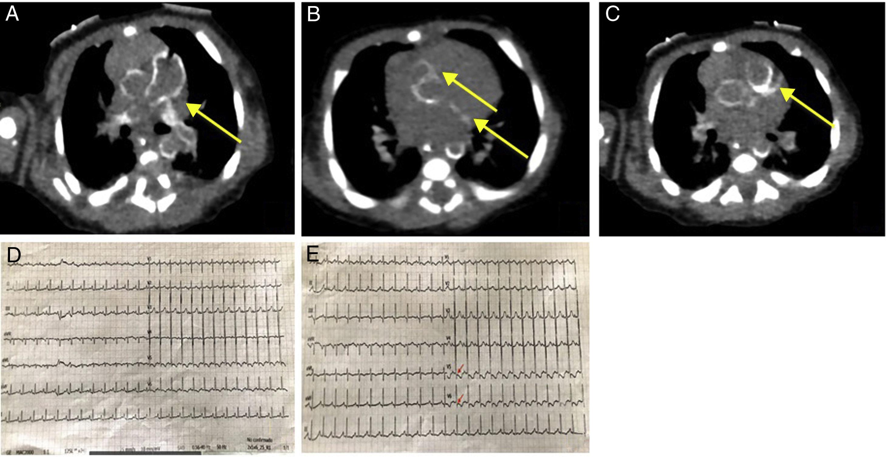 Neonatal myocardial ischemia and calcifications. Report of a case of ...