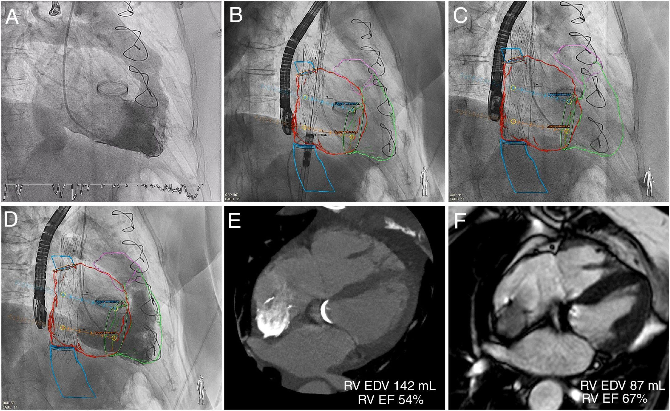 TRICENTO transcatheter heart valve for severe tricuspid regurgitation ...