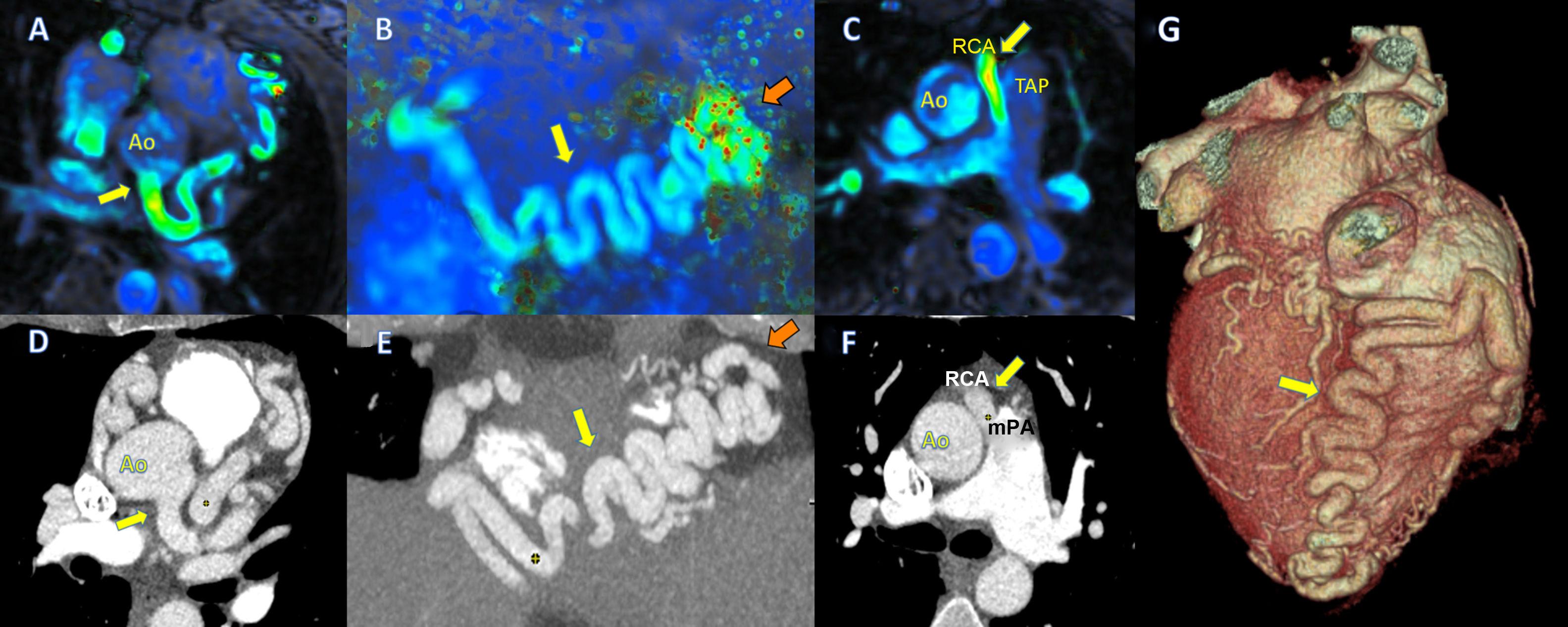 ARCAPA: 4D-flow cardiovascular magnetic resonance versus cardiac CT ...