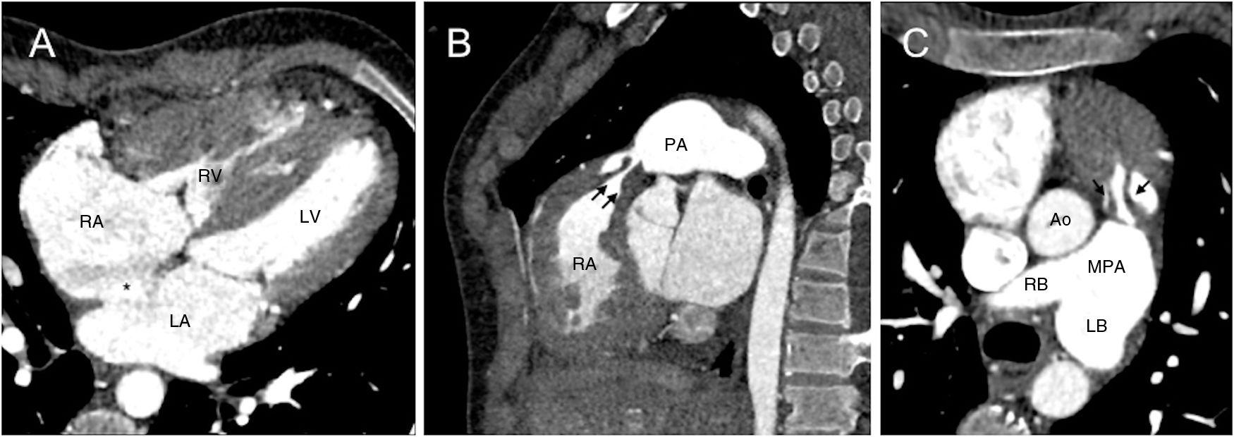 Infundibular pulmonary stenosis and single coronary artery | Revista ...