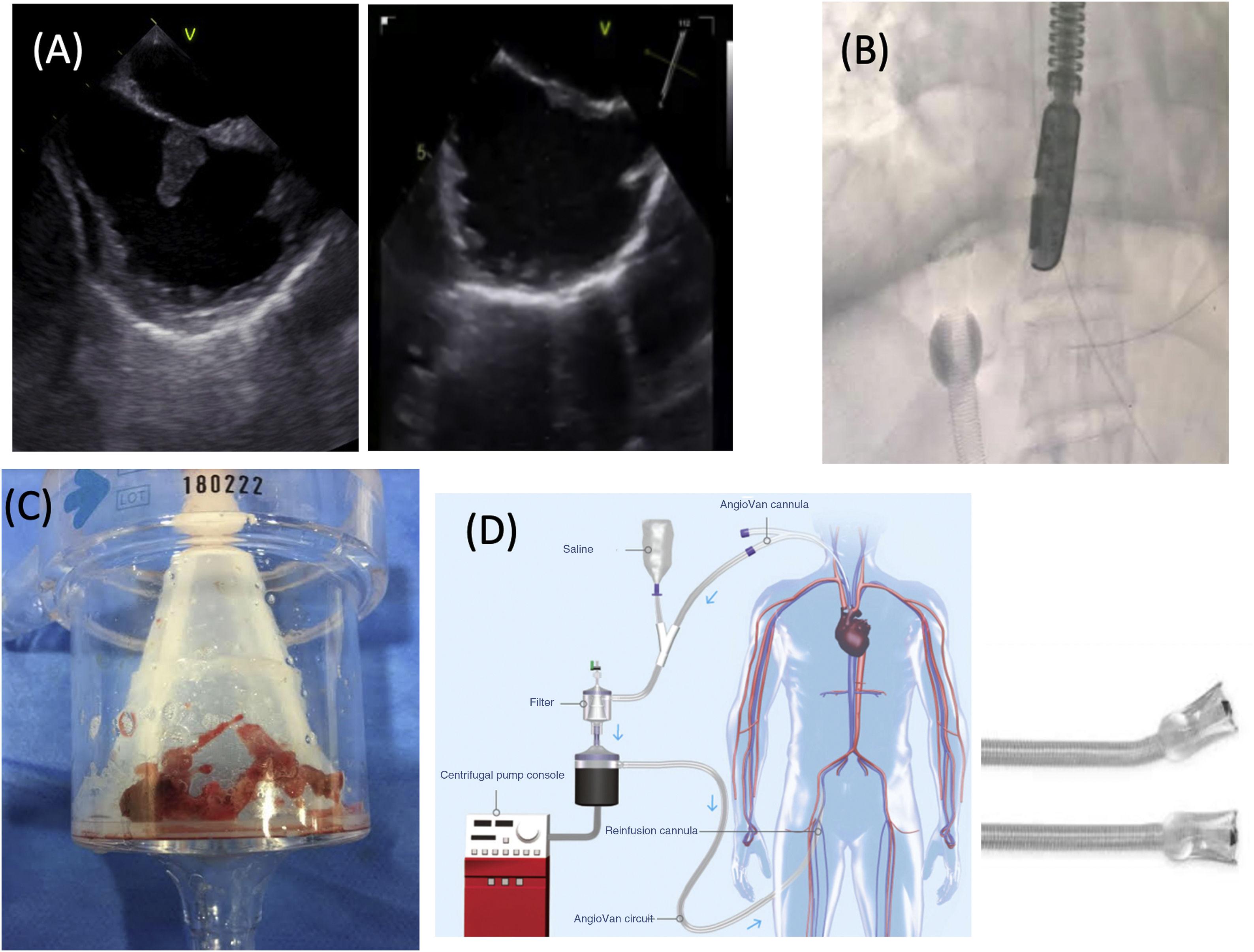 Atrial thrombus aspiration through the AngioVac system: an alternative ...
