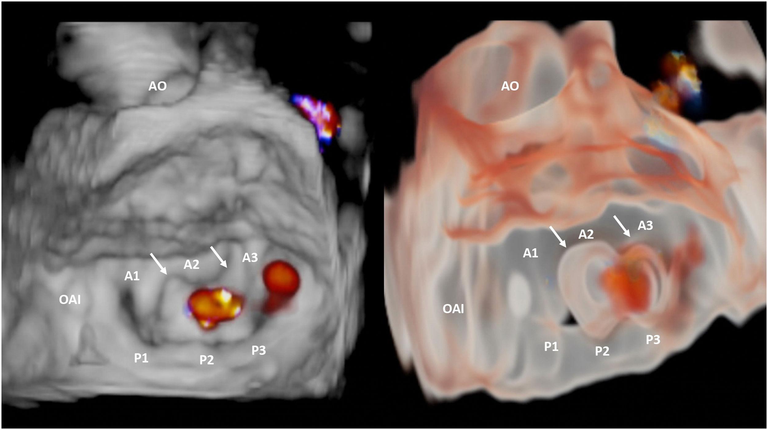 Latest developments in 3D echocardiography. A novel tissue transparency ...