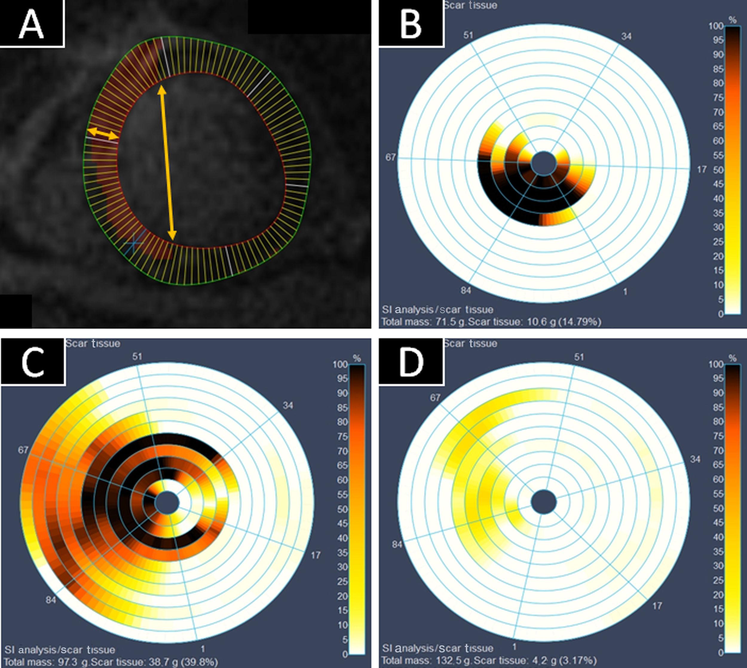 Coexistence of transmural and lateral wavefront progression of ...