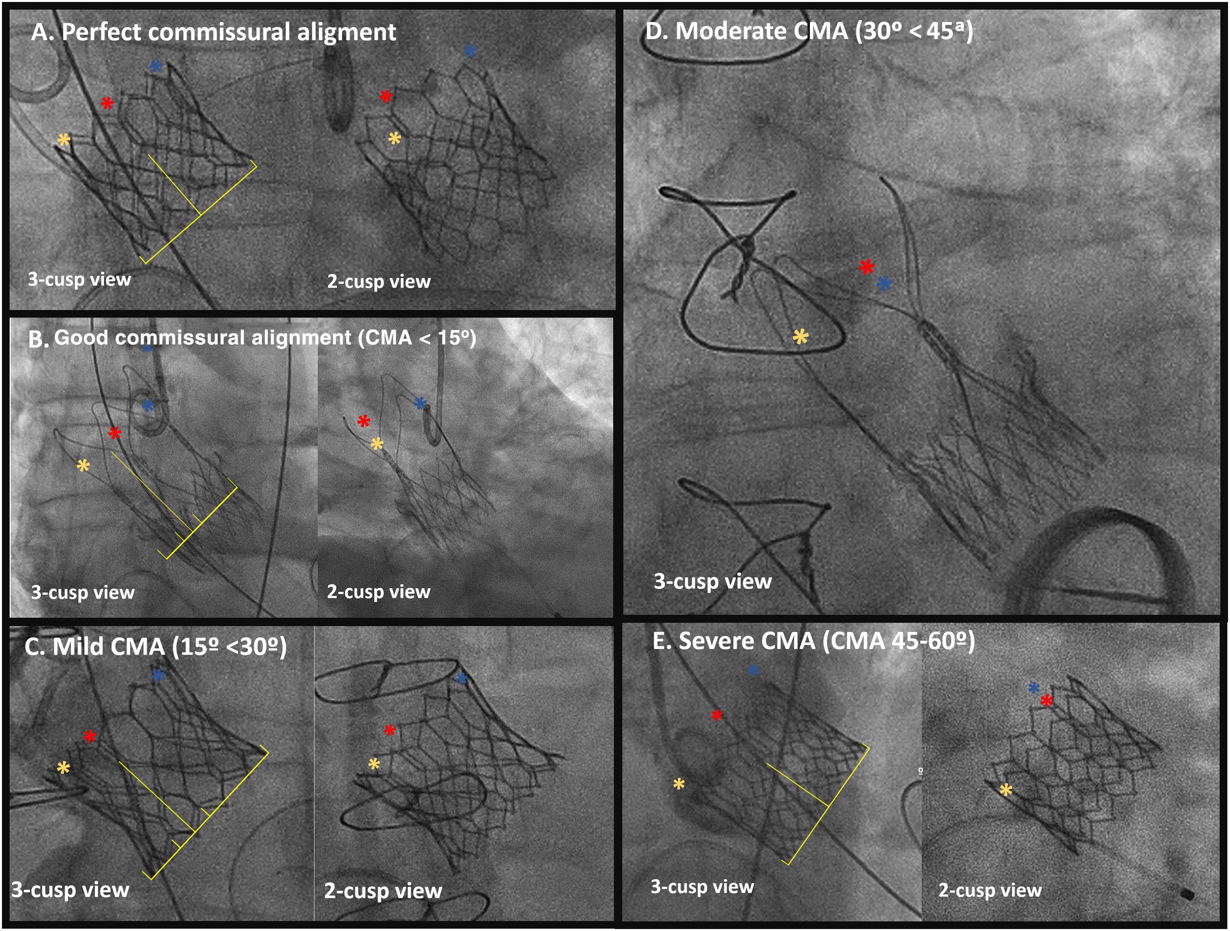 Fluoroscopic-based algorithm for commissural alignment assessment after ...