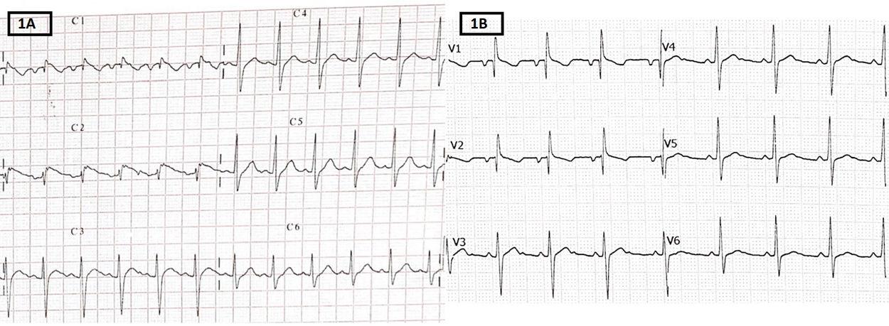 Brugada phenocopy in a child with pediatric inflammatory multisystemic ...