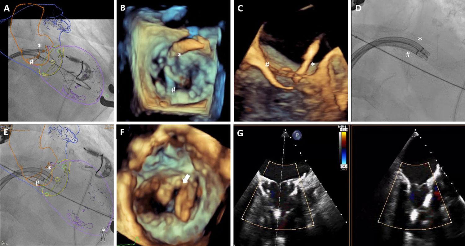 Tendyne valve facilitated by antegrade anterior mitral laceration ...