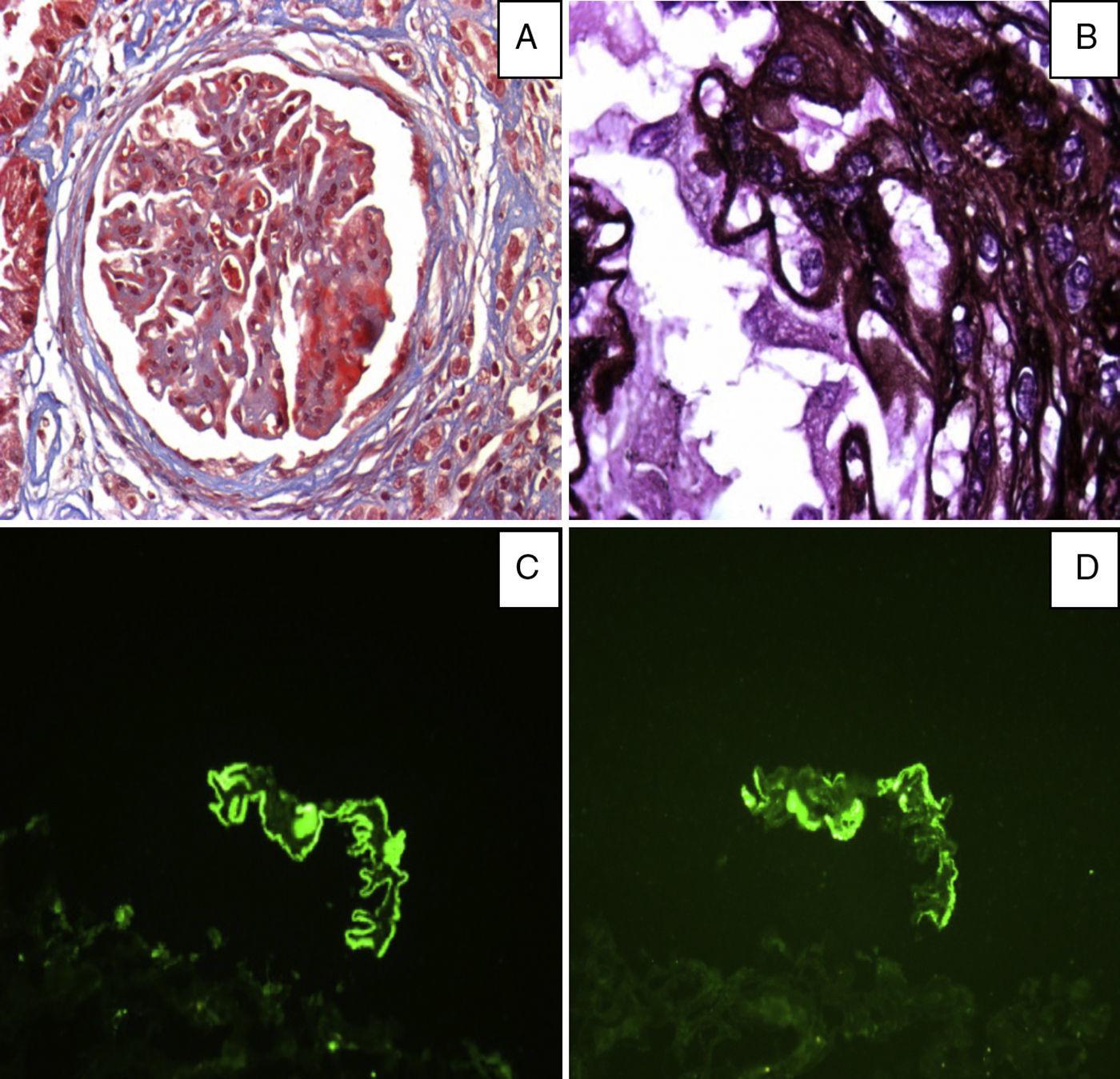 Consumo de C3 como única manifestación de nefropatía lúpica v/iii en ...