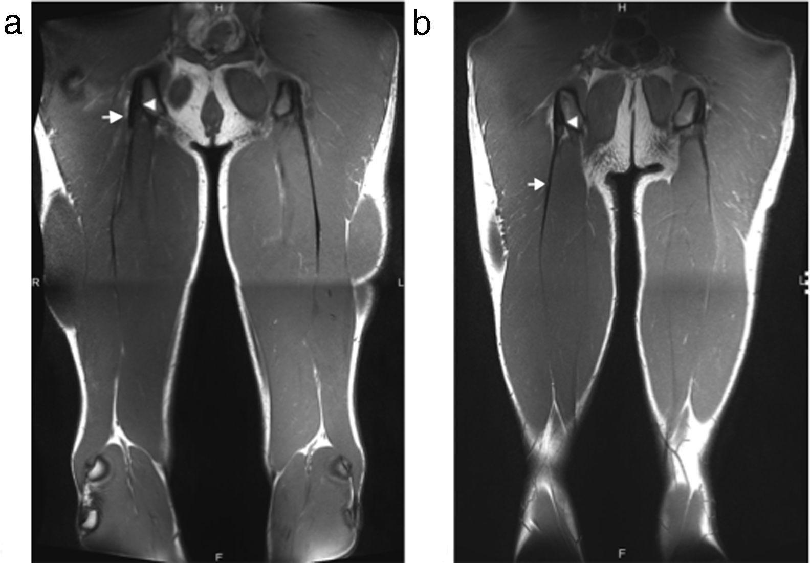 Length of the free tendon is not associated with return to play time in ...